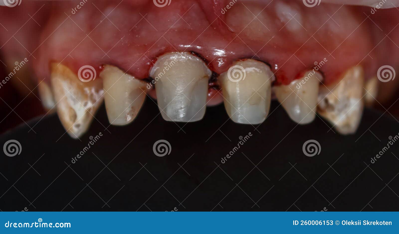 Teeth Restored with the Help of Composite Material and Processed for ...