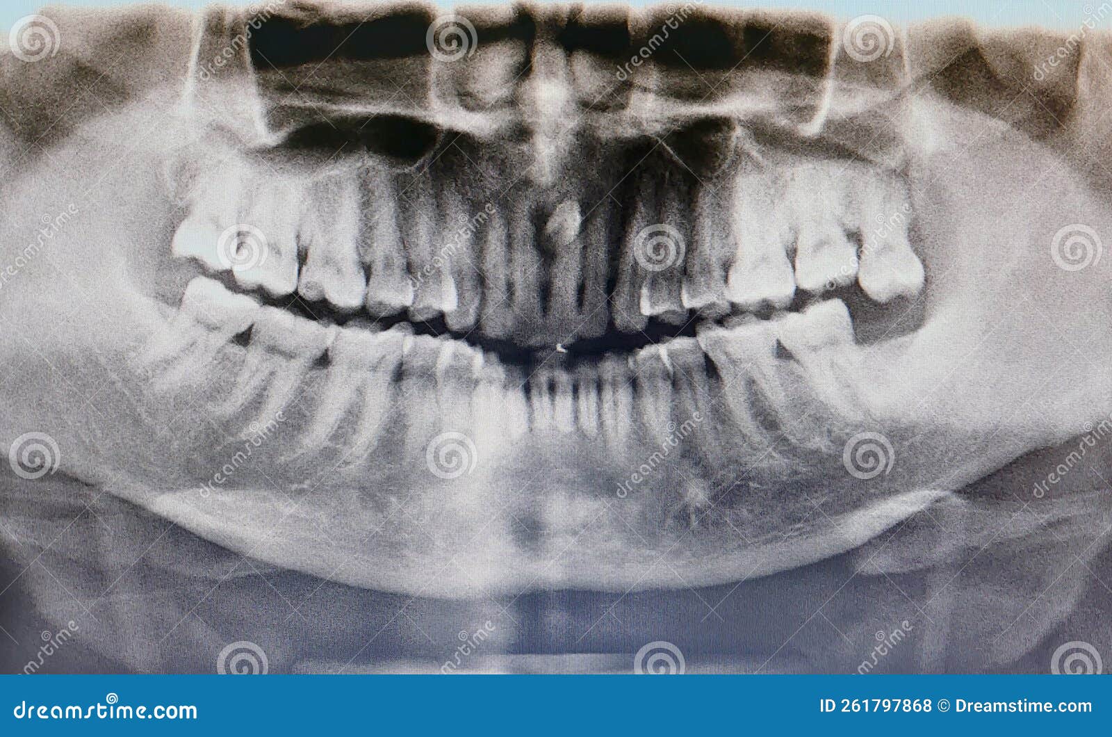 Teeth rontgen image stock photo. Image of tooth, rontgen - 261797868