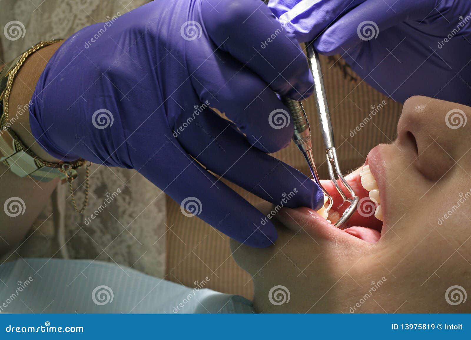 Teeth Scaling at Dentist stock image. Image of months - 13975819