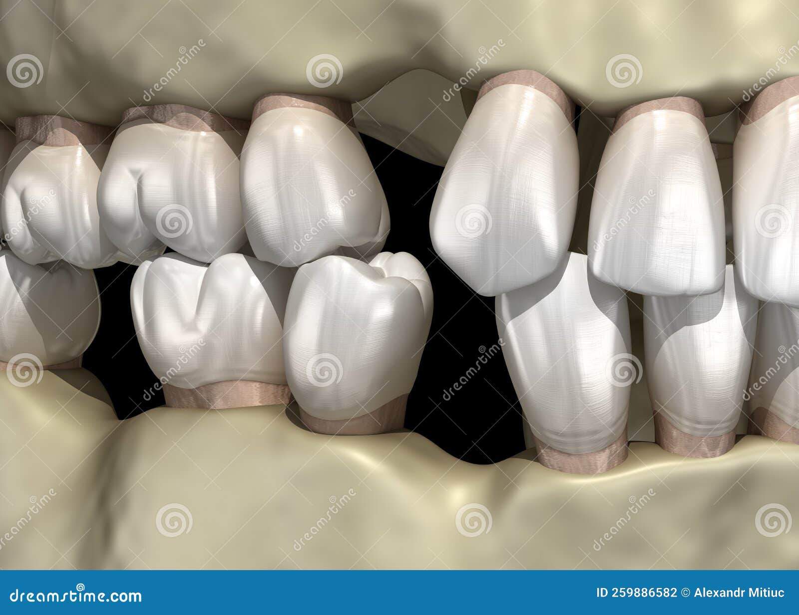 Teeth Shift Deformatiuon after Losing Teeth. 3D Illustration of Popov ...