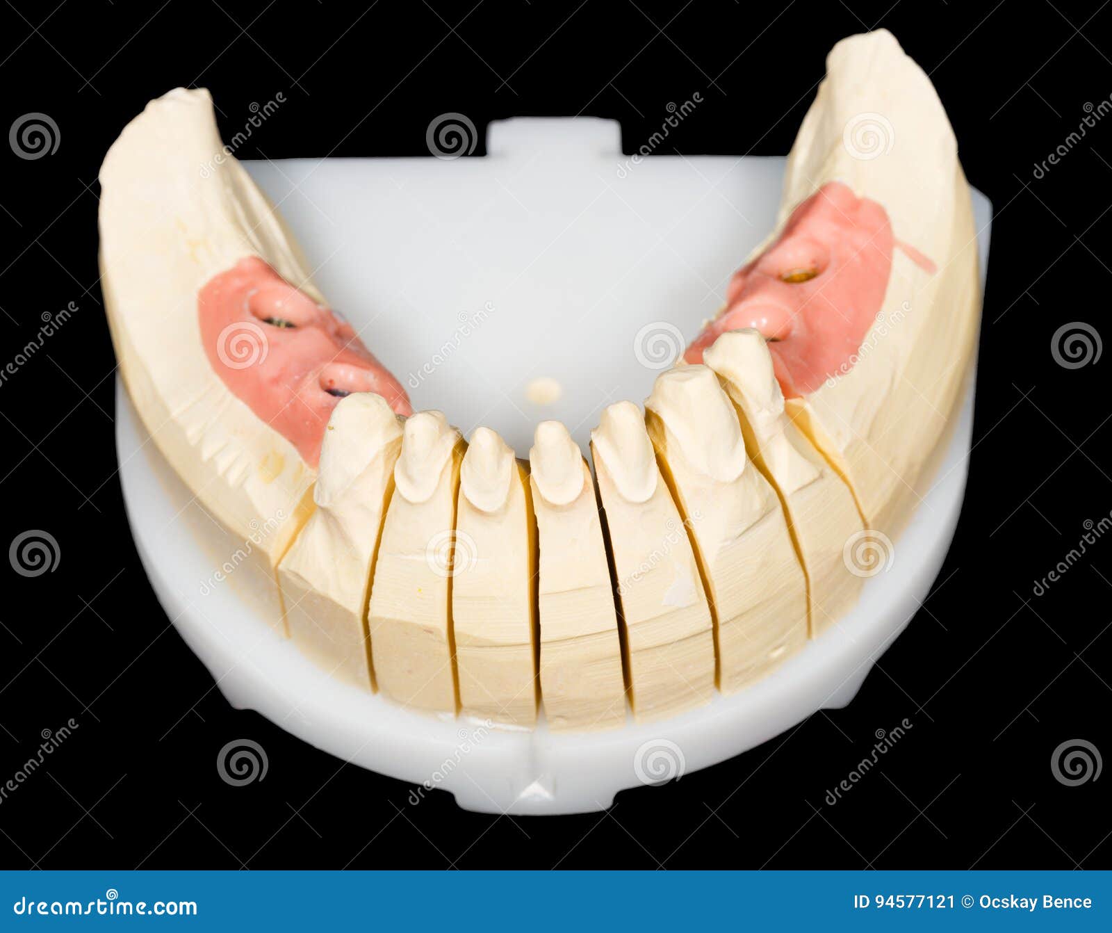 Teeth stump and implants stock image. Image of premolar - 94577121