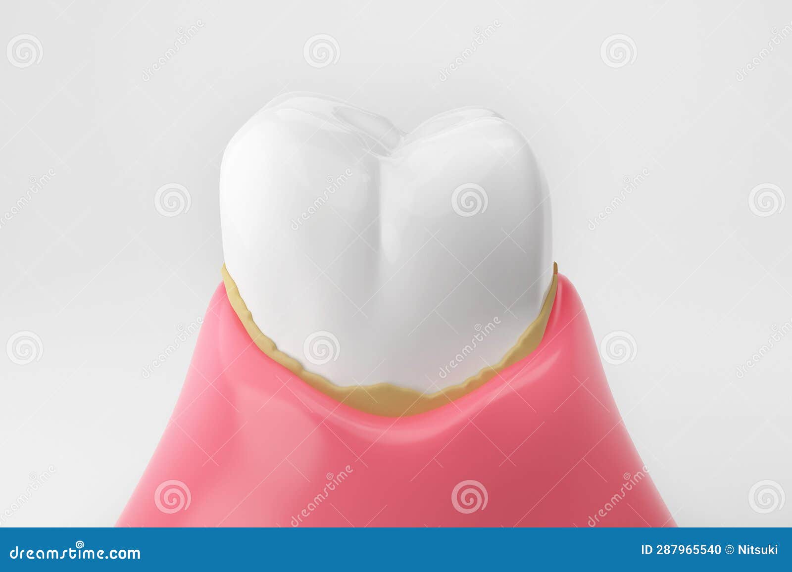 Teeth Tartar or Dental Calculus Stock Illustration - Illustration of ...