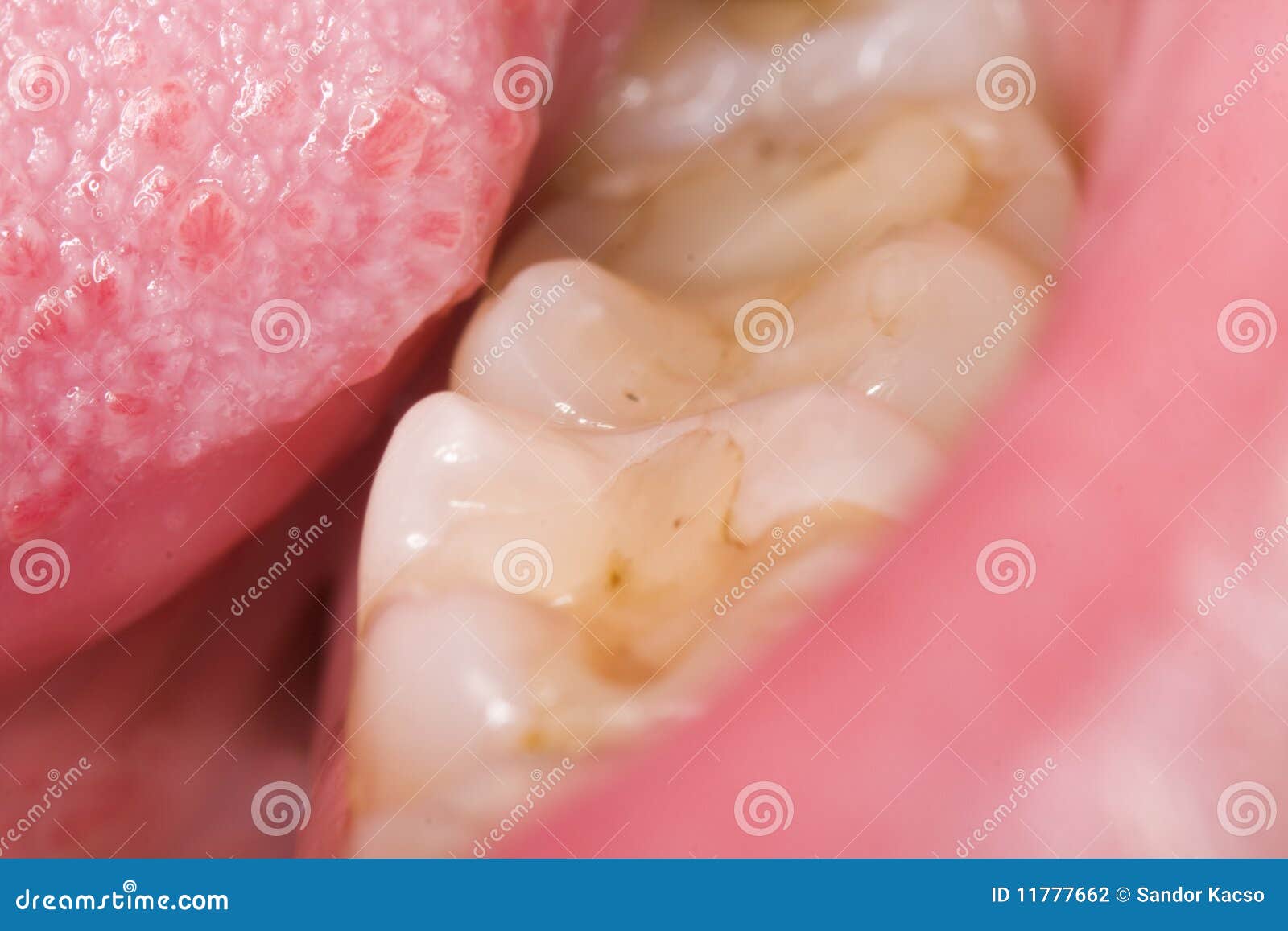 Teeth, Tongue, Tartar, Caries Stock Photo - Image of dental, obturation ...