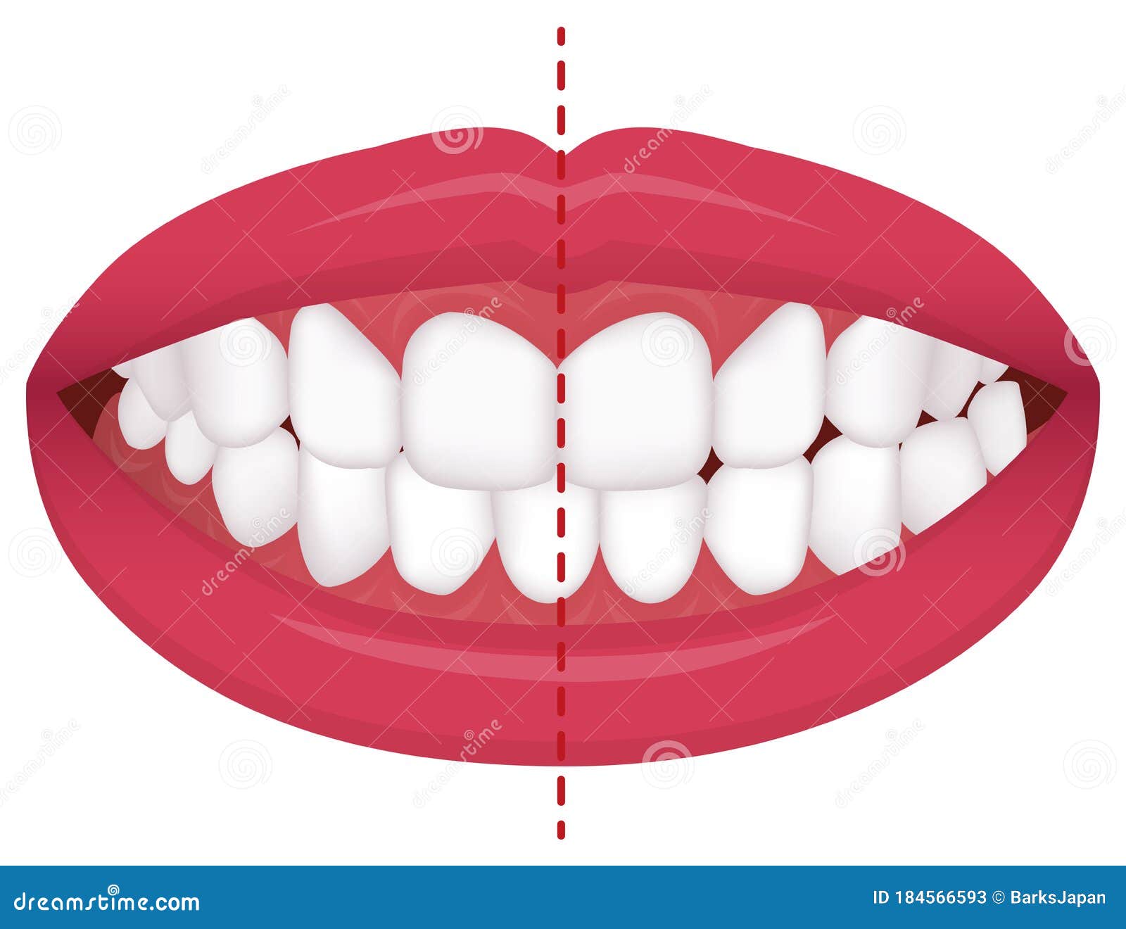 Teeth Trouble Bite Type / Crooked Teeth Vector Illustration /Crossbite ...