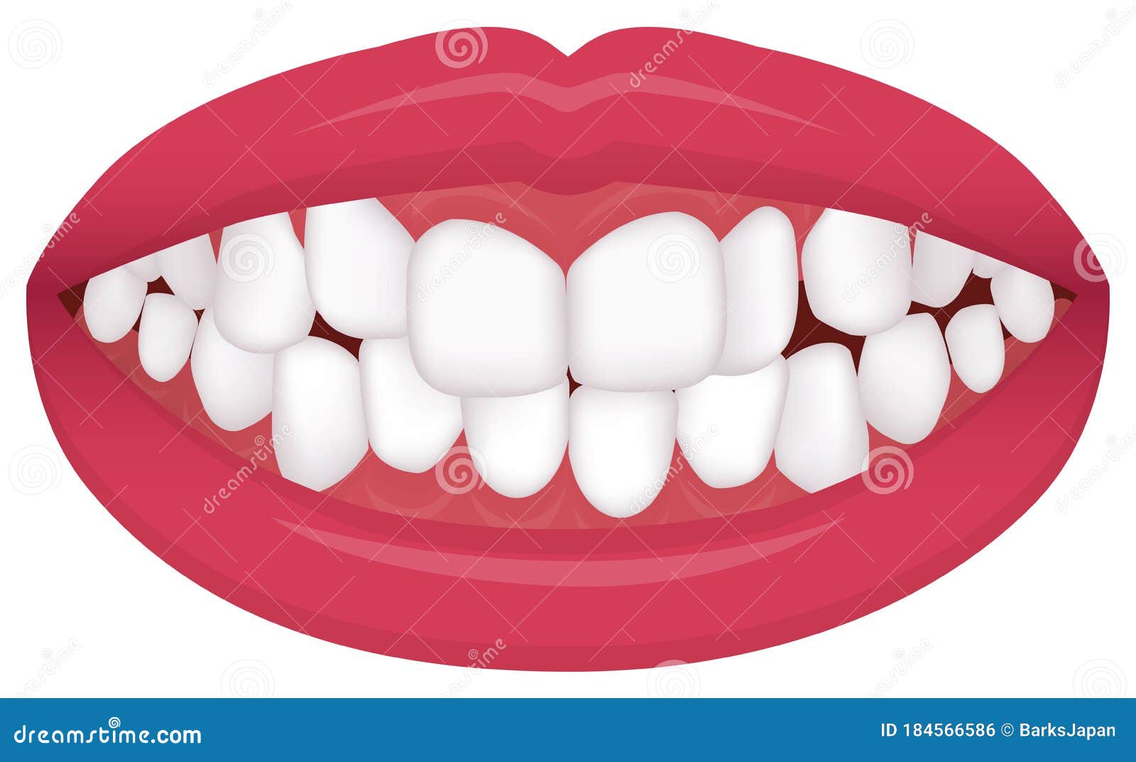 Teeth Trouble Bite Type / Crooked Teeth Vector Illustration /Crowding ...