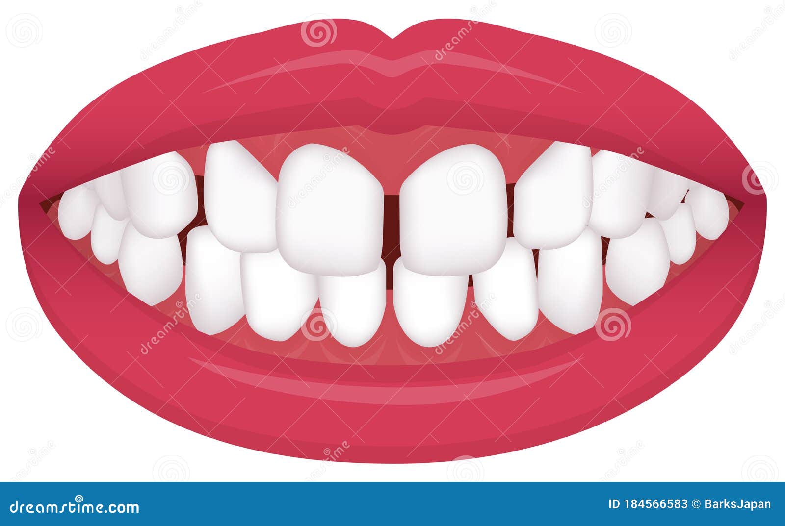 Spacing Teeth Diastema Vector Illustration | CartoonDealer.com #93804838