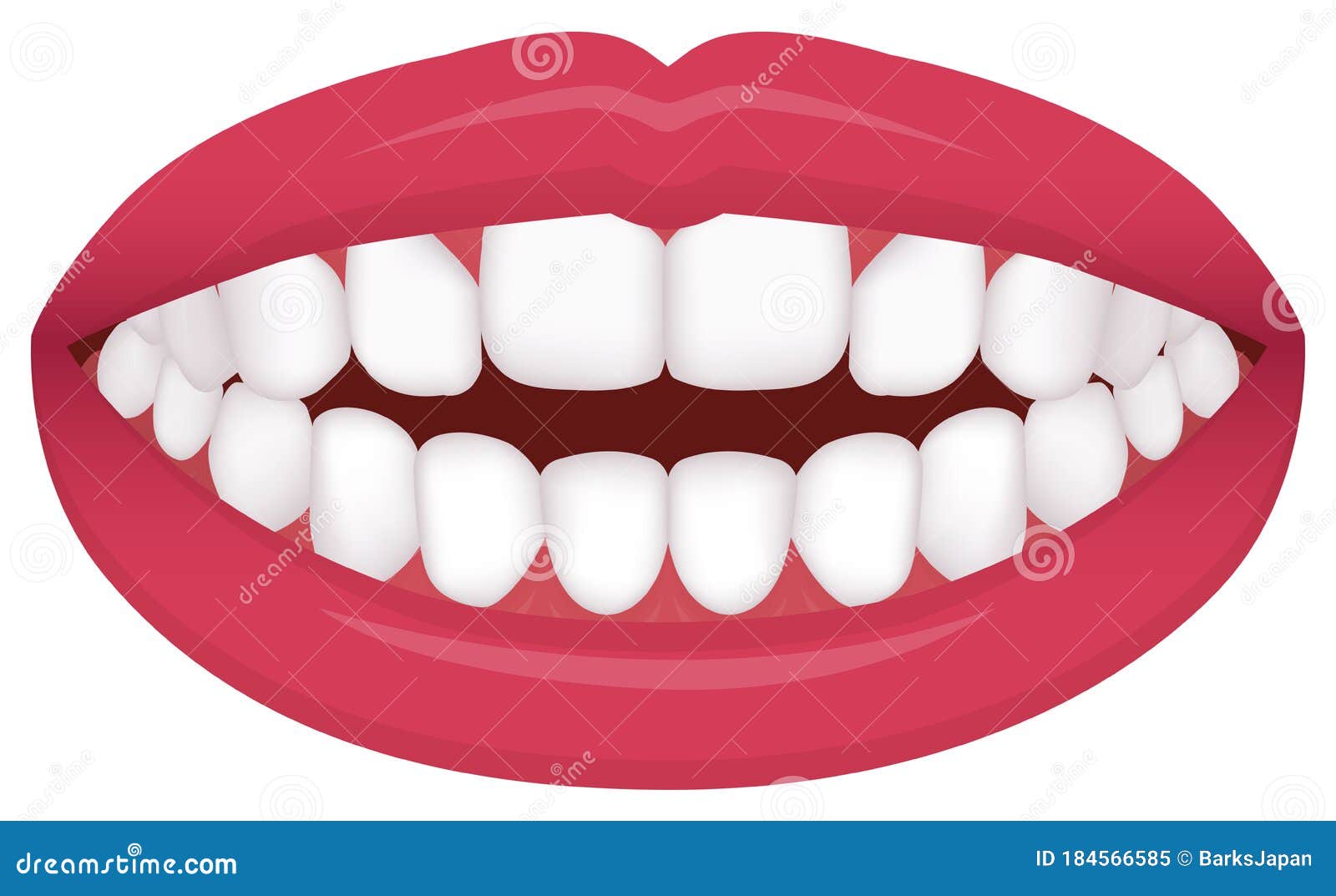 Teeth Trouble Bite Type / Crooked Teeth Vector Illustration /Open Bite ...