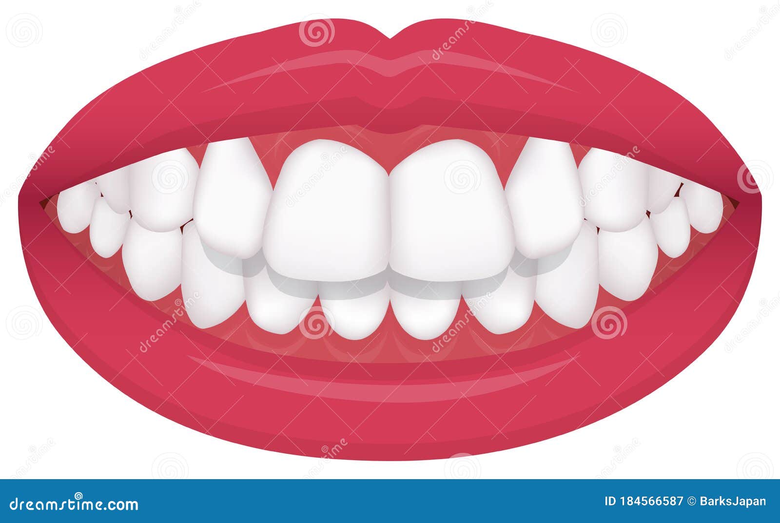Teeth Trouble Bite Type / Crooked Teeth Vector Illustration /Overbite ...