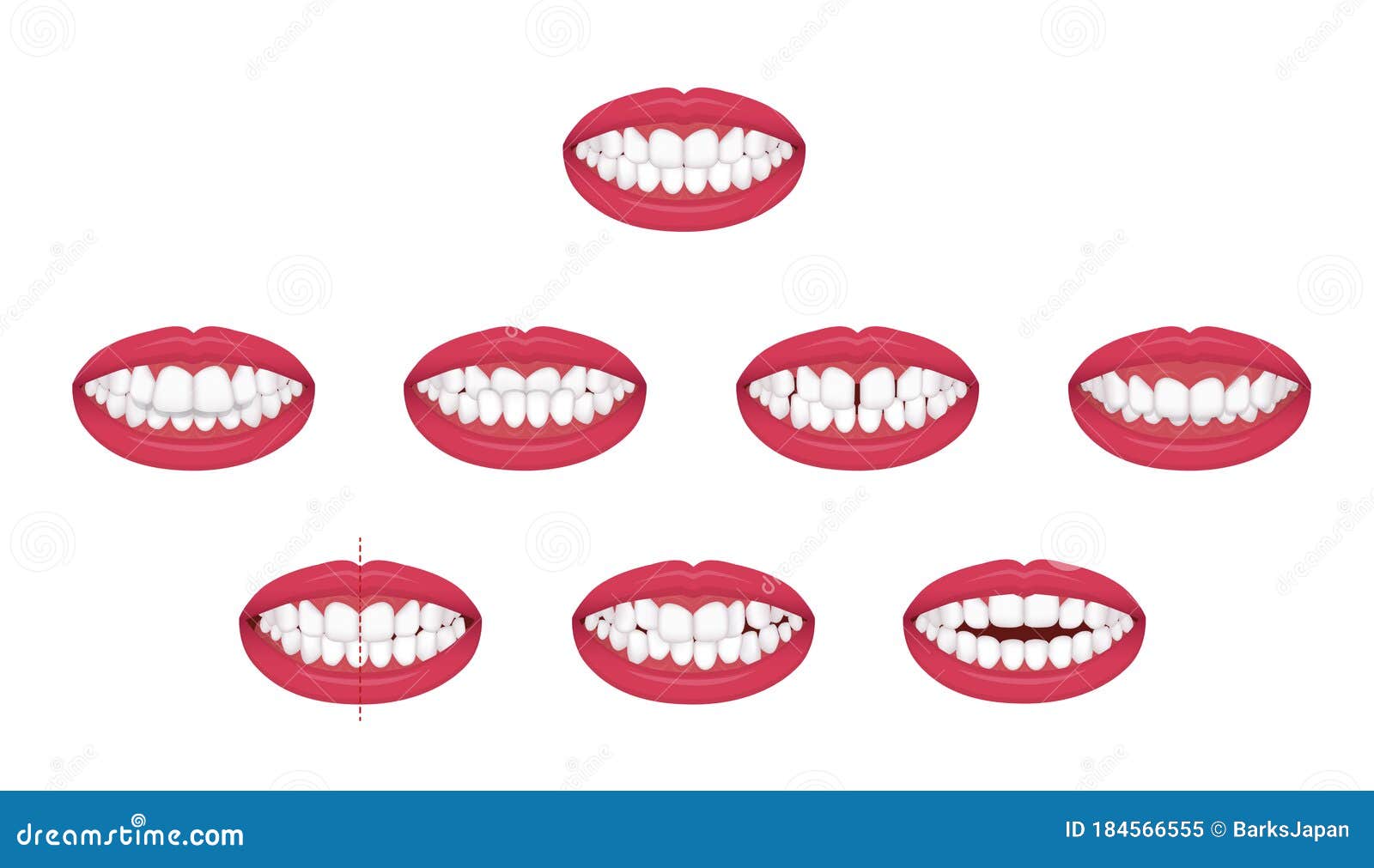 Teeth Trouble Bite Type / Crooked Teeth Vector Illustration /Crossbite ...