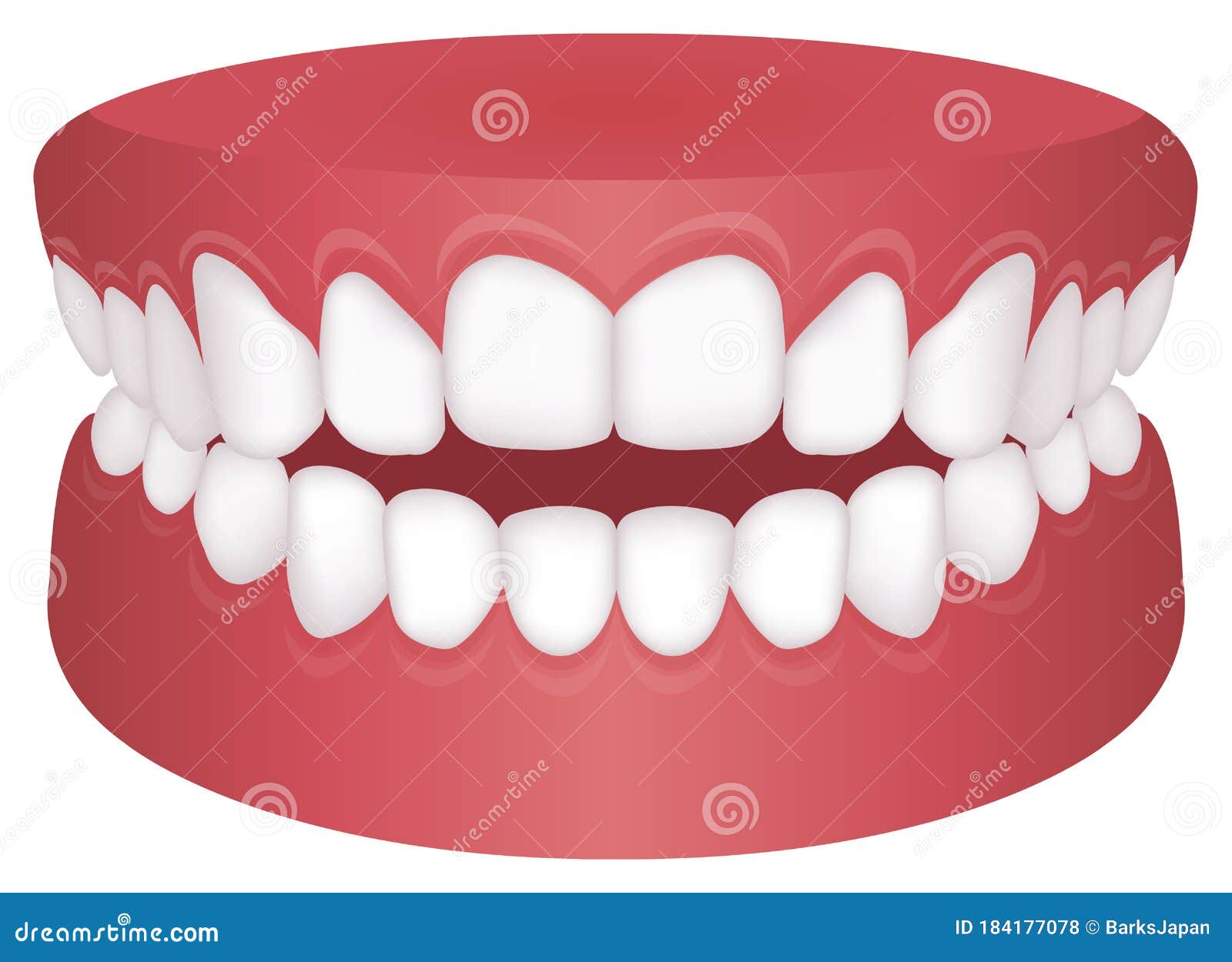 Teeth Trouble Bite Type Vector Illustration /Open Bite Stock Vector ...