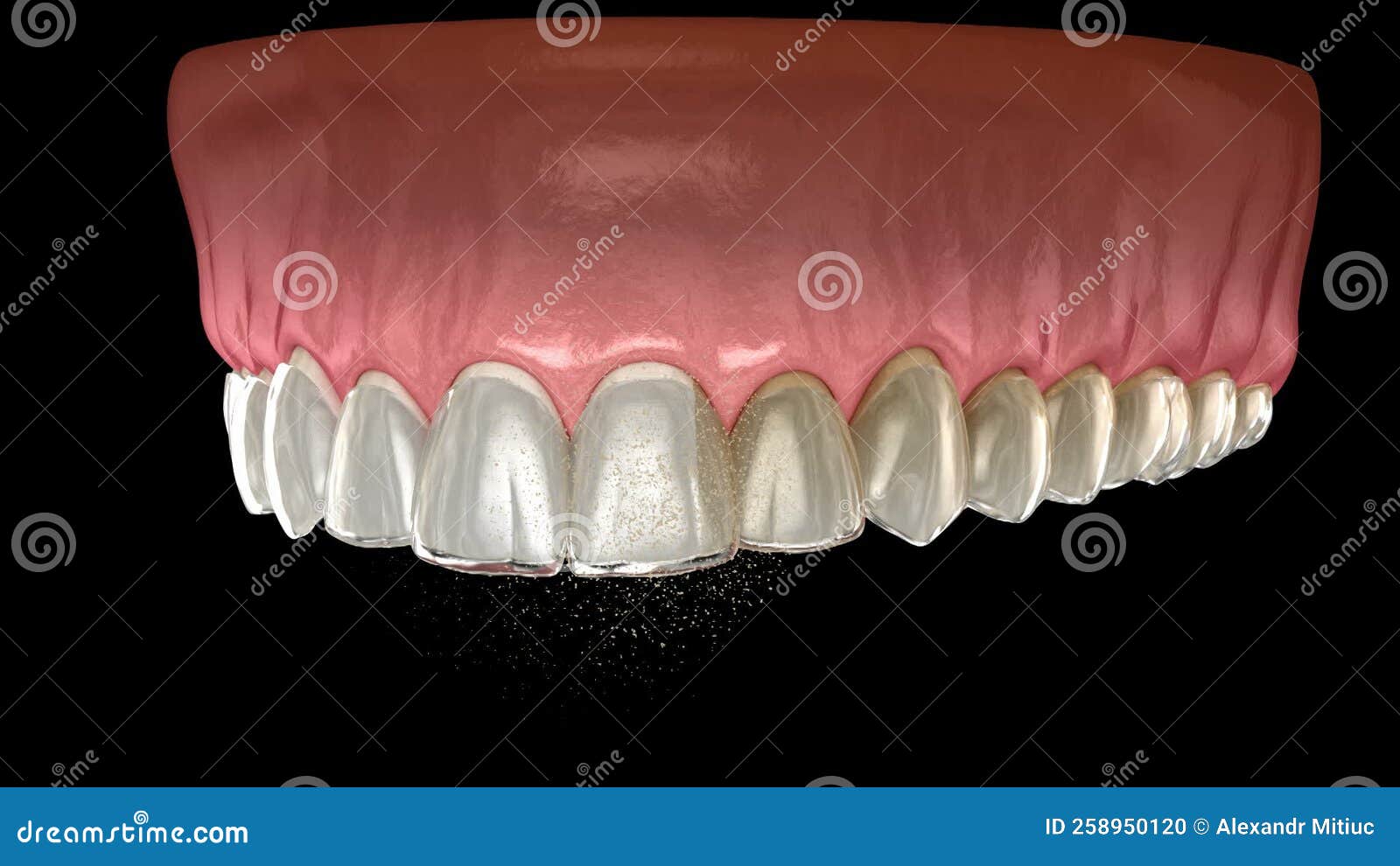 Teeth Whitening with Invisalign Braces or Invisible Retainer. 3D ...