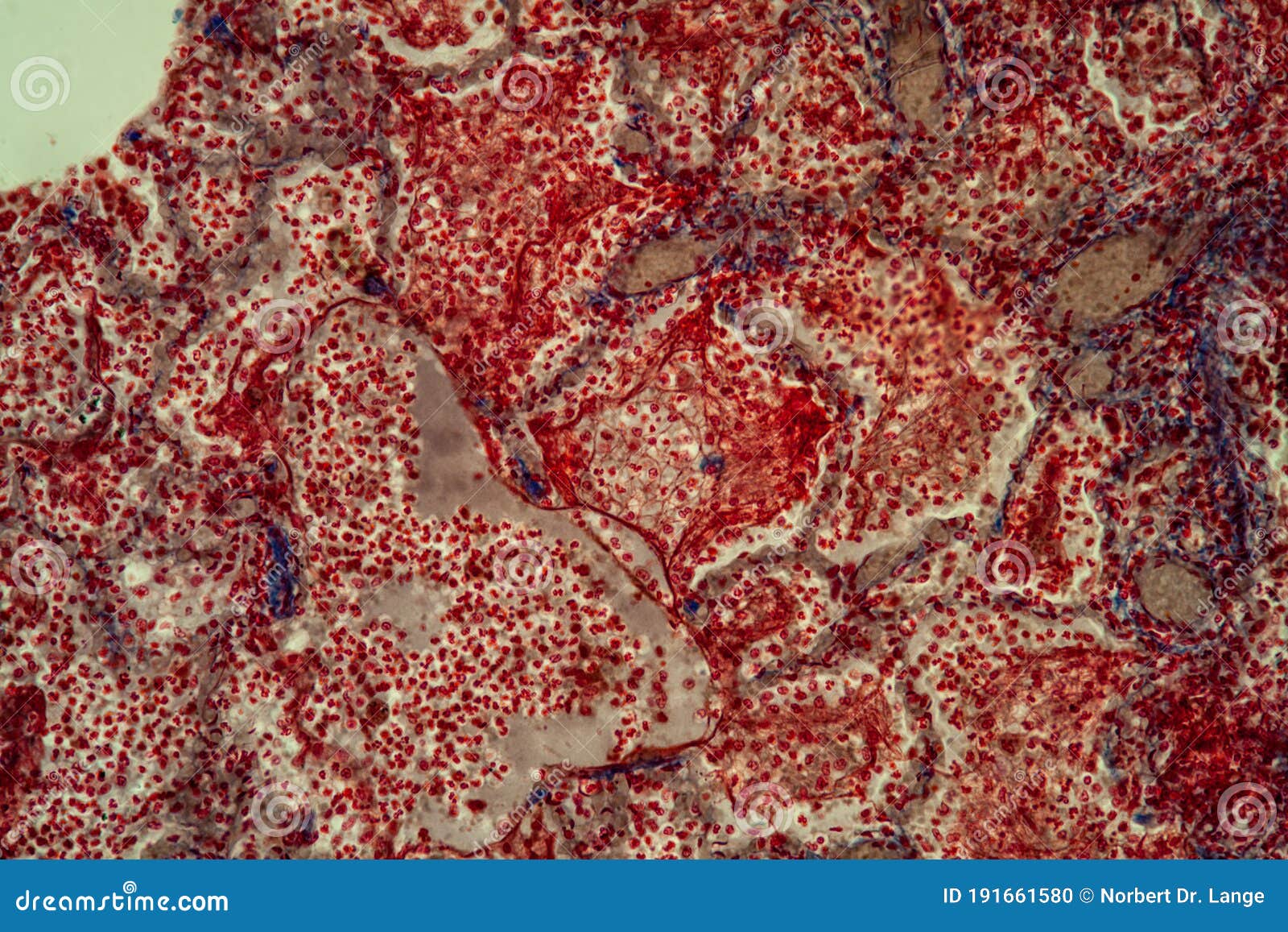 Tejido Pulmonar De Tuberculosis 200 X Foto de archivo - Imagen de ...