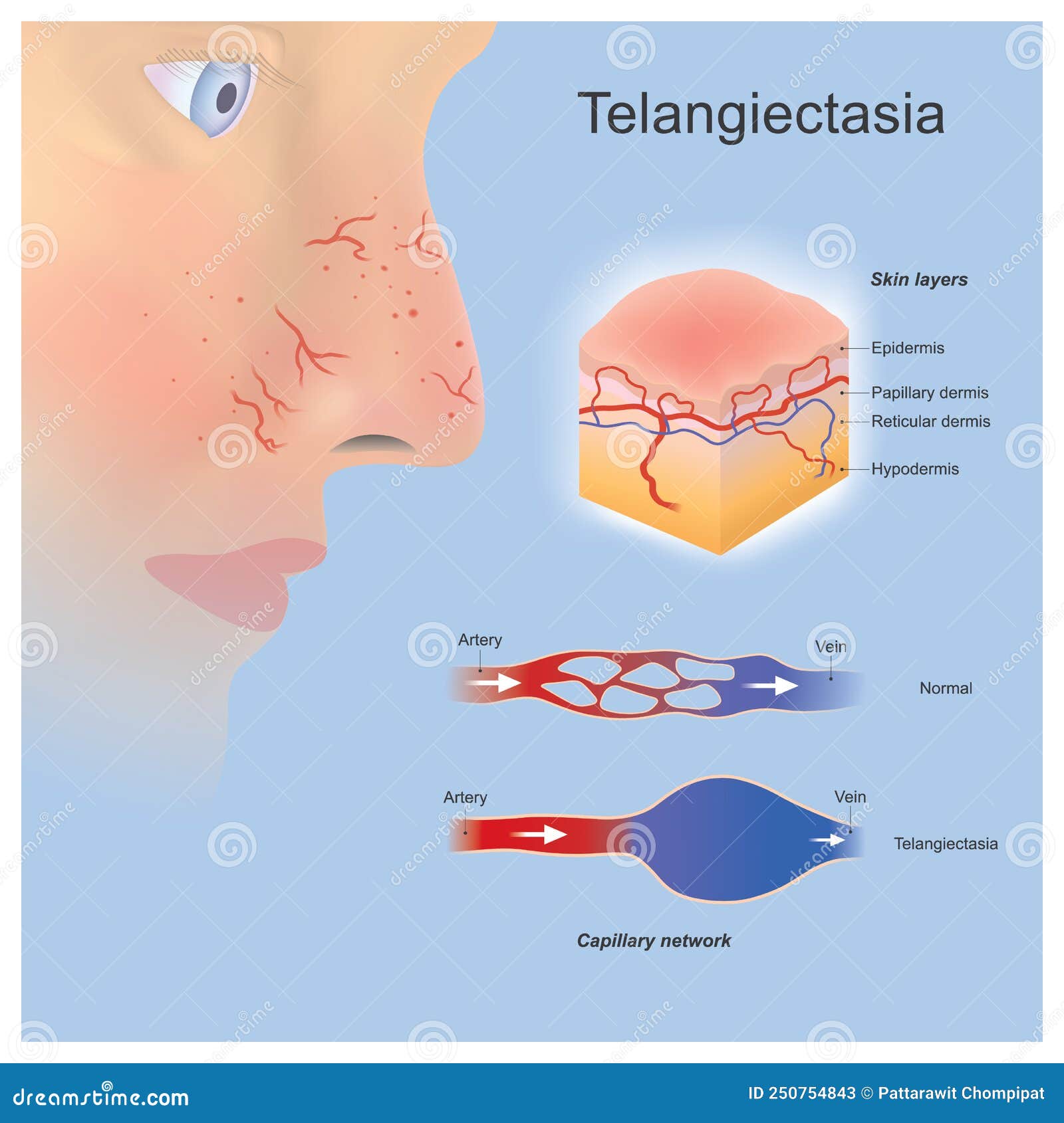 Telangiectasia. Problem Tiny Blood Vessels Widened Or Formed Located ...