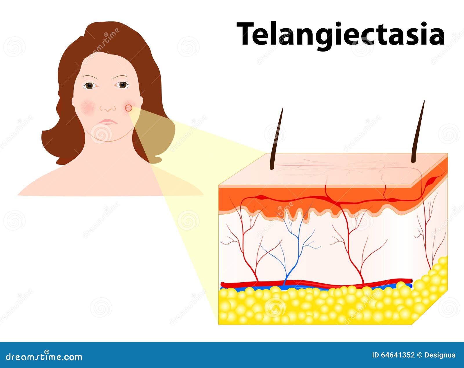 Telangiectasias. Spider Veins or Angioectasias Stock Vector ...