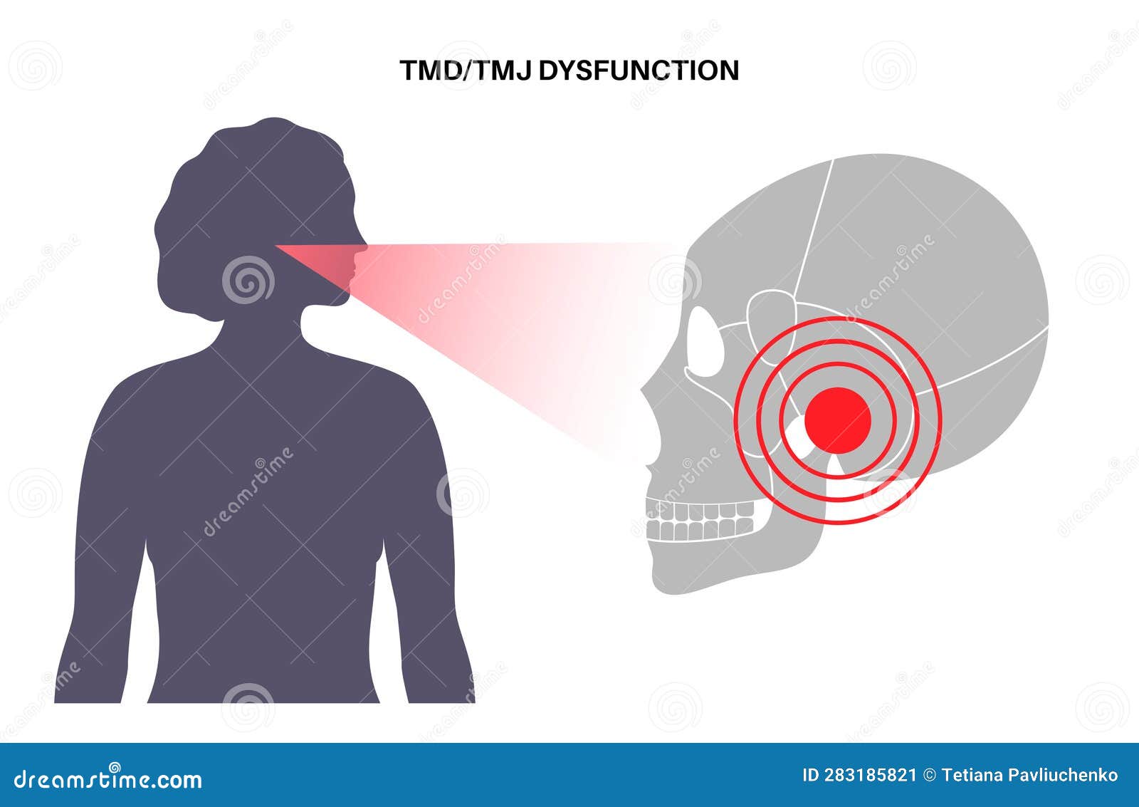 Tmd Tmj Disorder Stock Vector Illustration Of Neuropathic 283185821