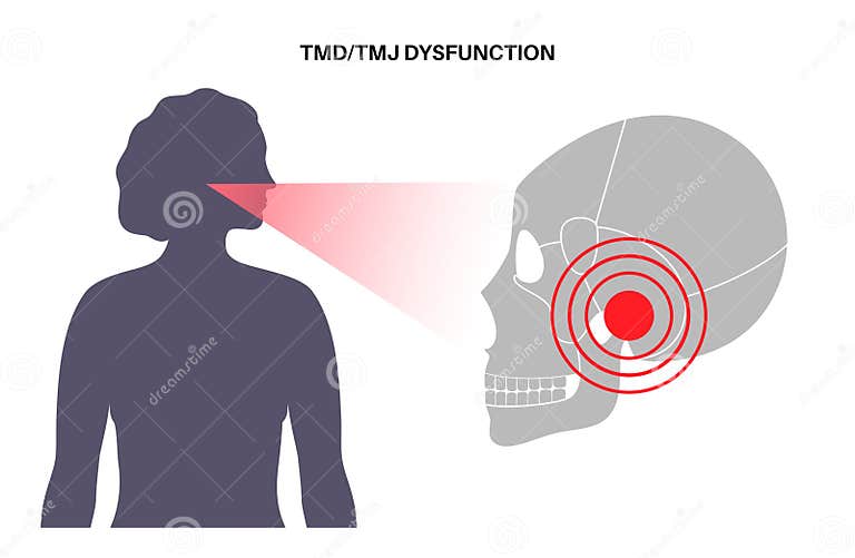 Tmd Tmj Disorder Stock Vector Illustration Of Neuropathic 283185821