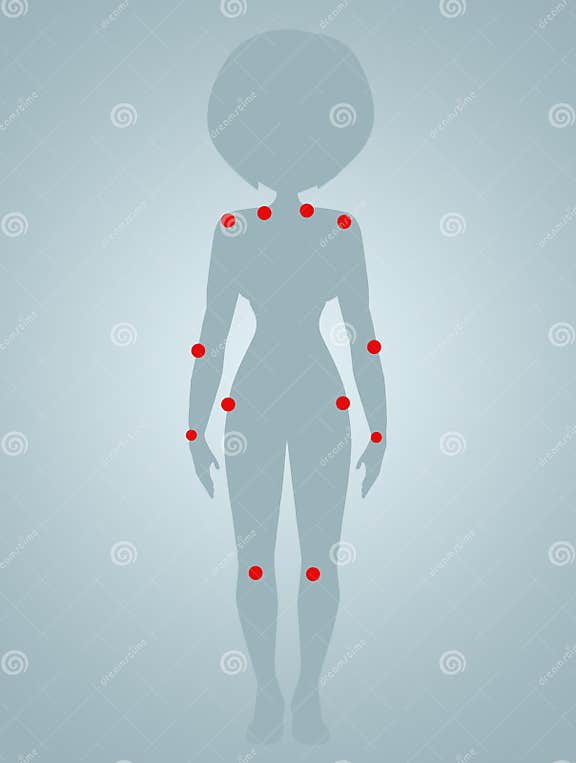 Tender Points of Fibromyalgia Stock Illustration - Illustration of ...