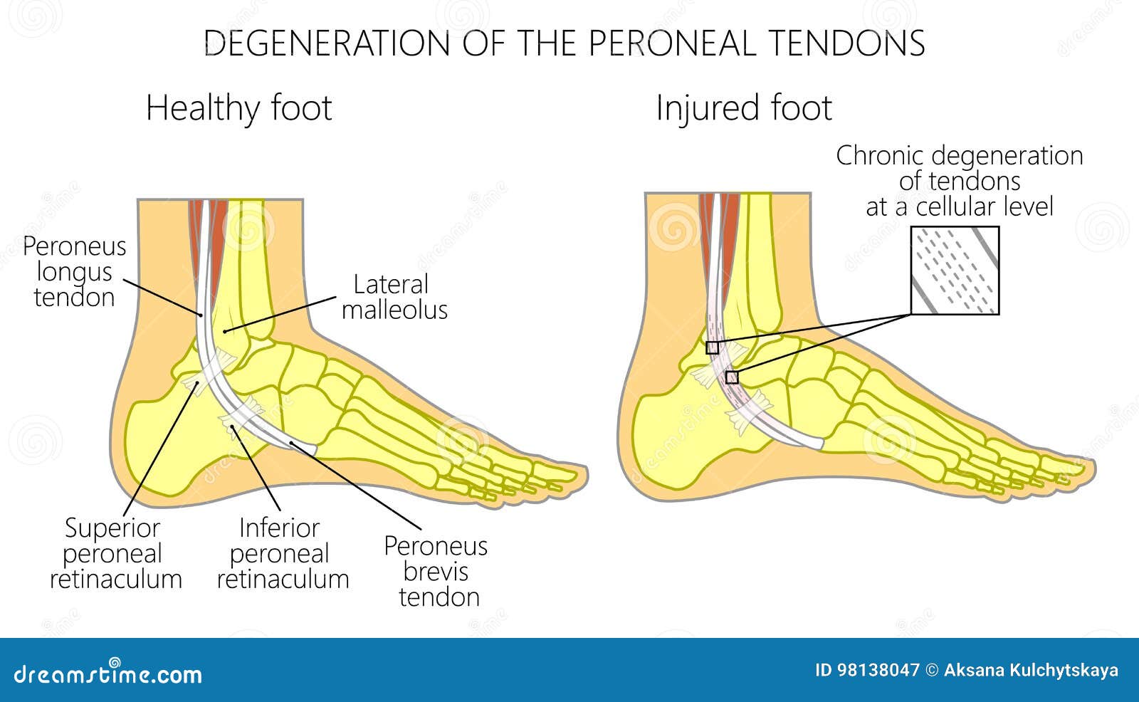 Tendine Peroneo Injuries_Degeneration Del Longus Di Peroneus E ...
