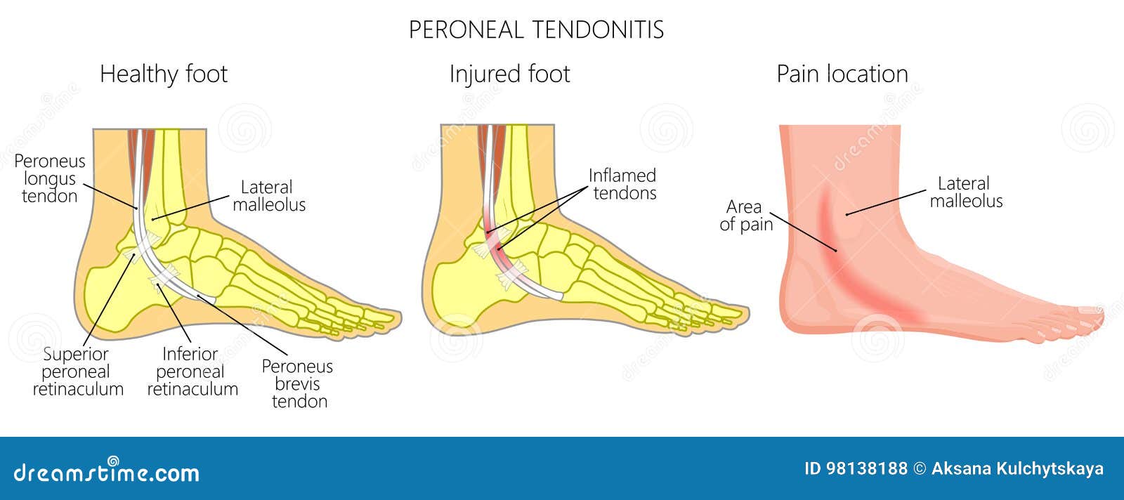 Tendinite Peronea Di Injuries_Peroneal Del Tendine Illustrazione ...
