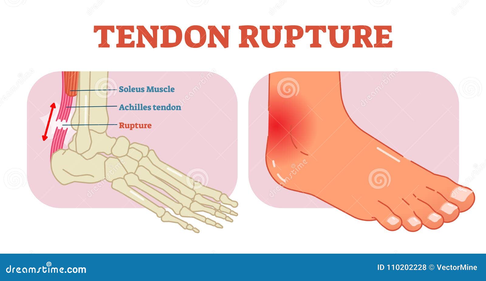 Tendon Rupture Anatomical Example, Vector Illustration Diagram ... Tendon Rupture Anatomical Example, Vector Illustration Diagram ...