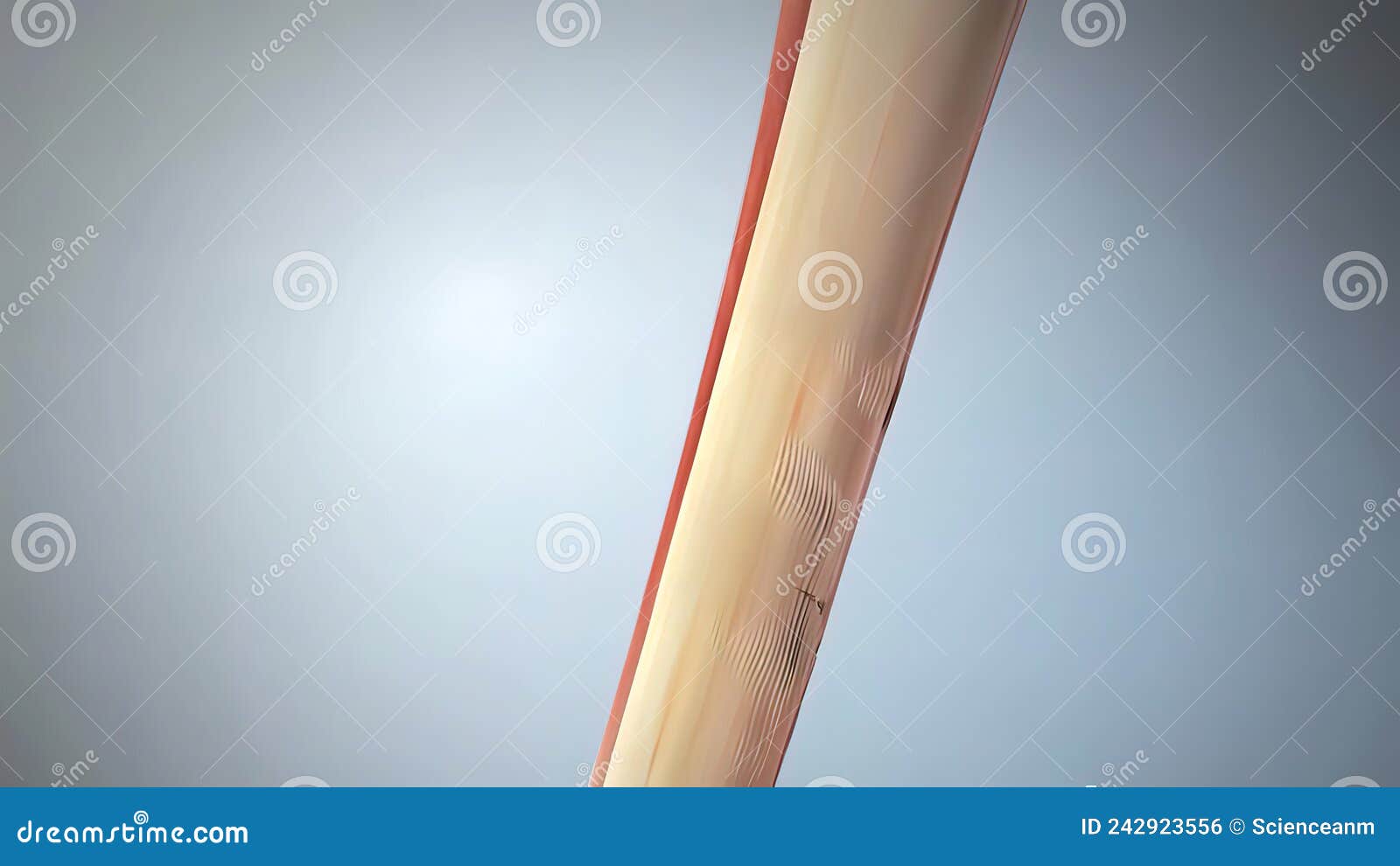 Tendon Rupture is a Long Partial or Complete Tear of the Tendon Stock ...