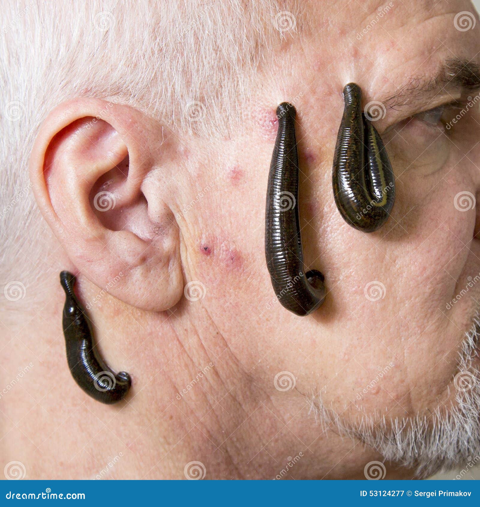 Terapia da sanguessuga imagem de stock. Imagem de sugar - 53124277