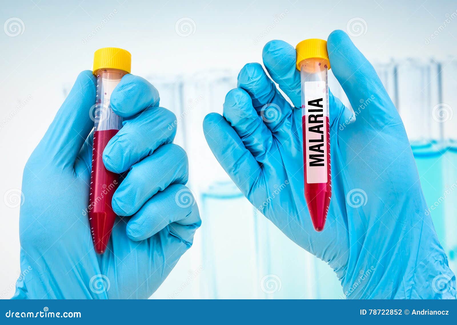 Test-tube with Blood Sample for MALARIA Test Stock Photo - Image of ...