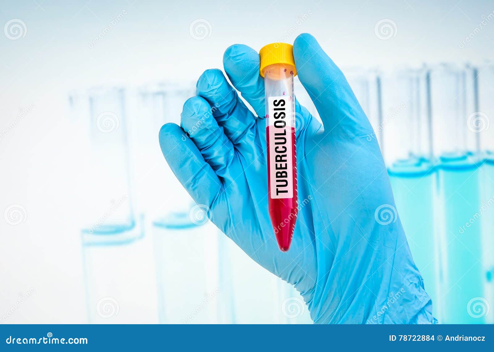 Test-tube with Blood Sample for TUBERCULOSIS Test Stock Photo - Image ...