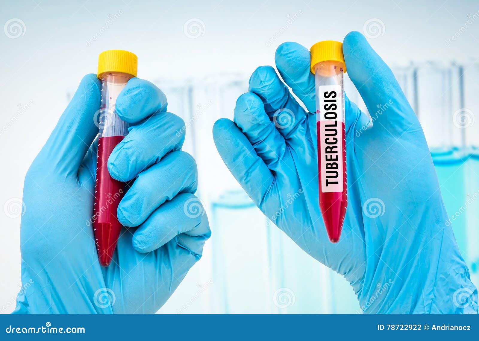 Test-tube with Blood Sample for TUBERCULOSIS Test Stock Photo - Image ...