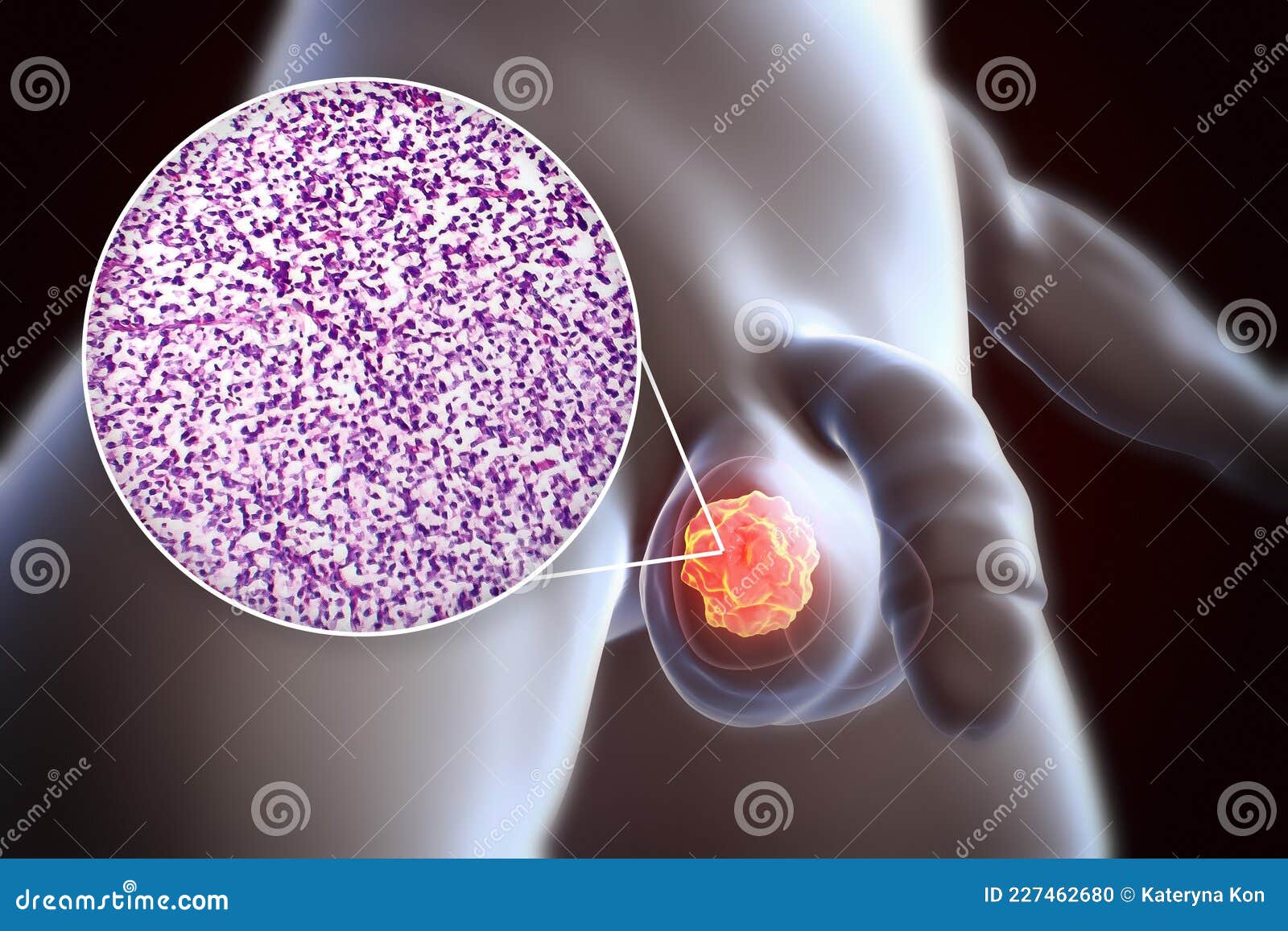 Testicular Cancer 3d Illustration And Light Micrograph Stock