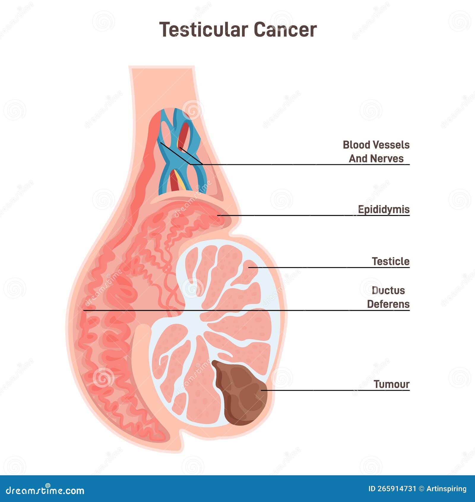 Testicular Cancer Pathological Malignant Tumor Develops In The