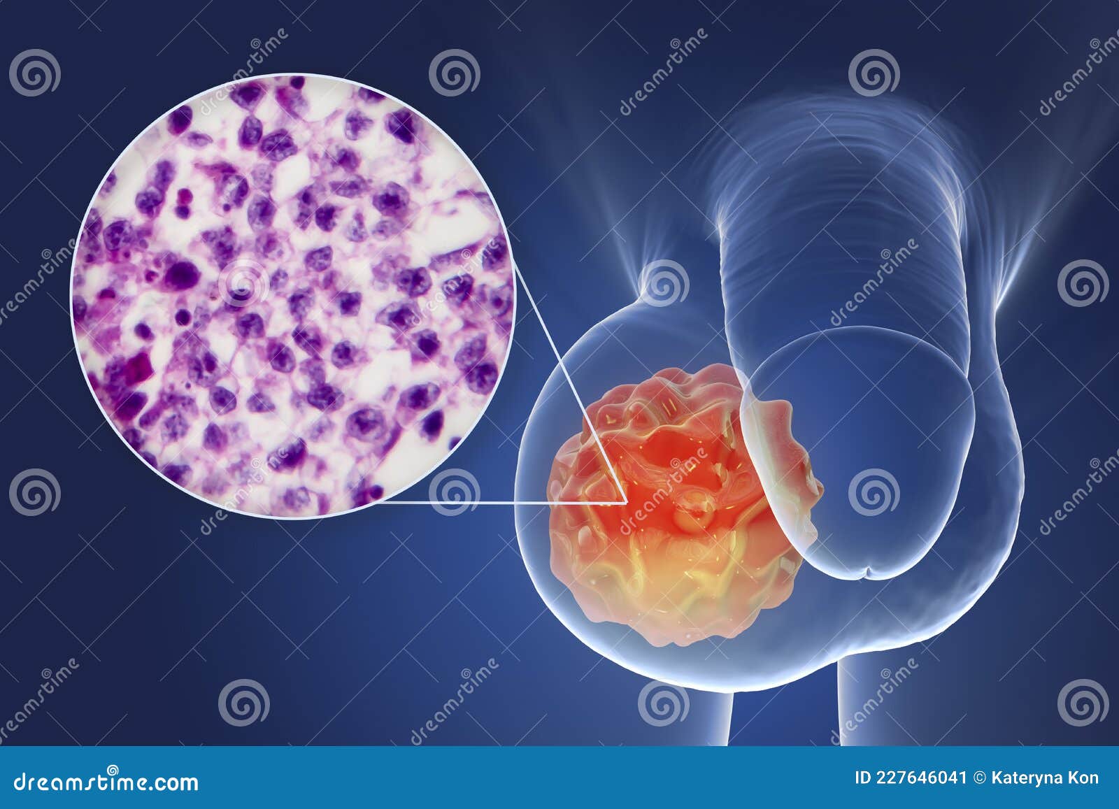 Testicular Cancer 3d Illustration And Light Micrograph Stock