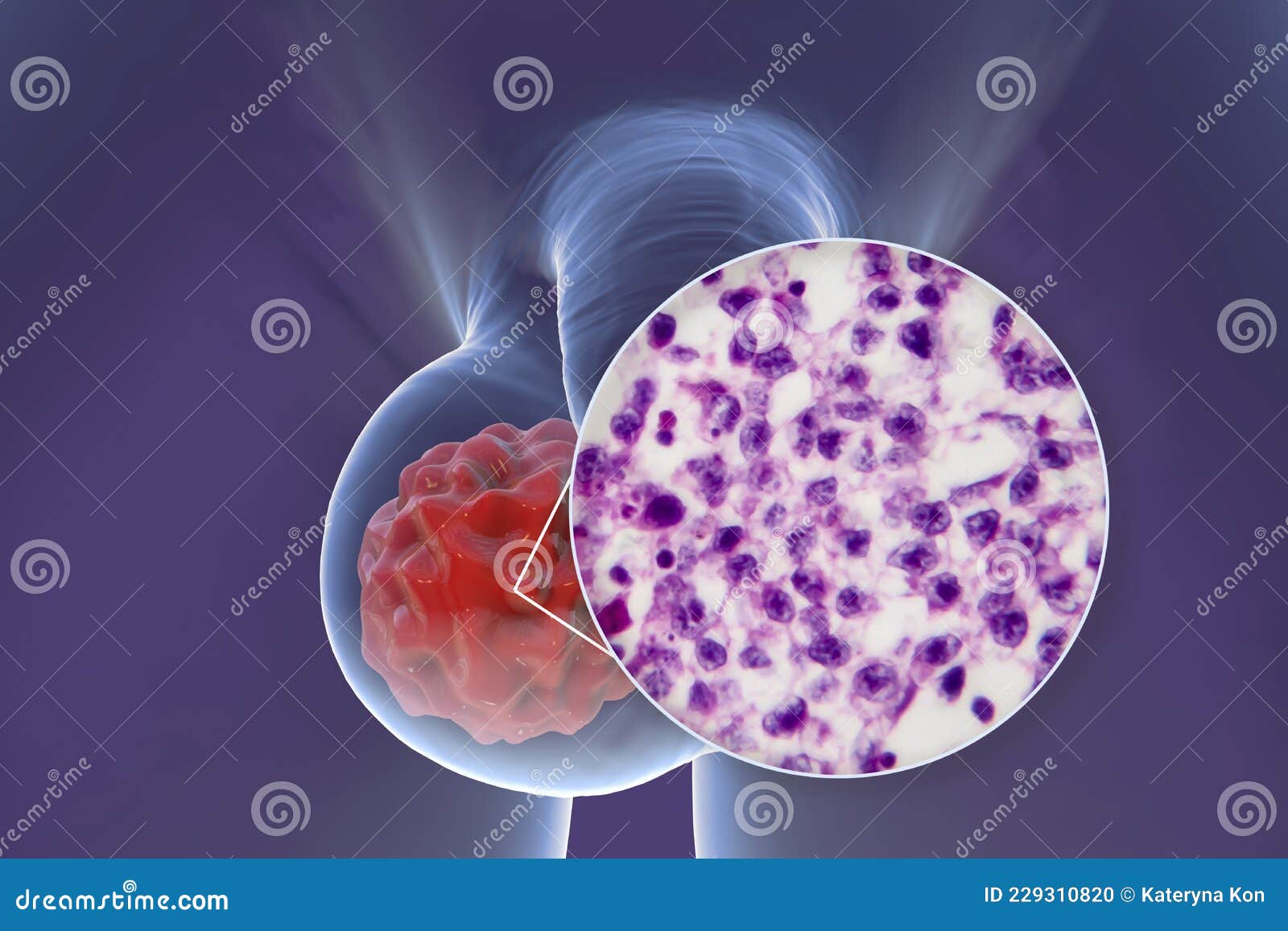 Testicular Cancer Testicular Seminoma Medical 3d Illustration And