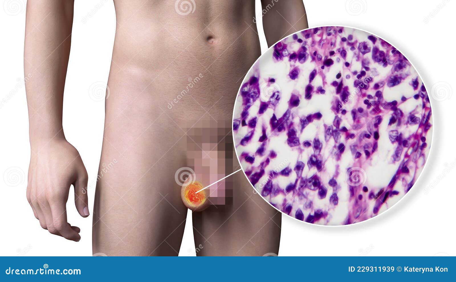Testicular Cancer Testicular Seminoma Medical 3d Illustration And