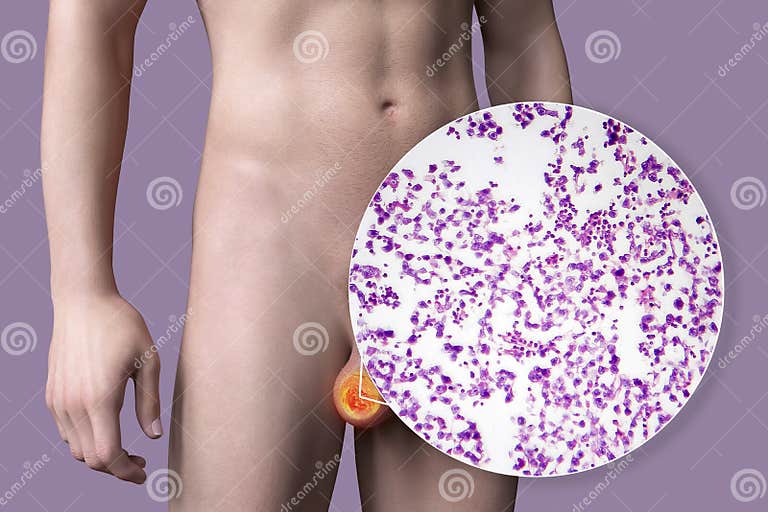 Testicular Cancer Testicular Seminoma Medical 3d Illustration And
