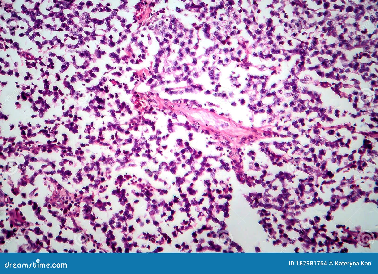 Testicular Seminoma, Light Micrograph Stock Photo - Image of micrograph ...