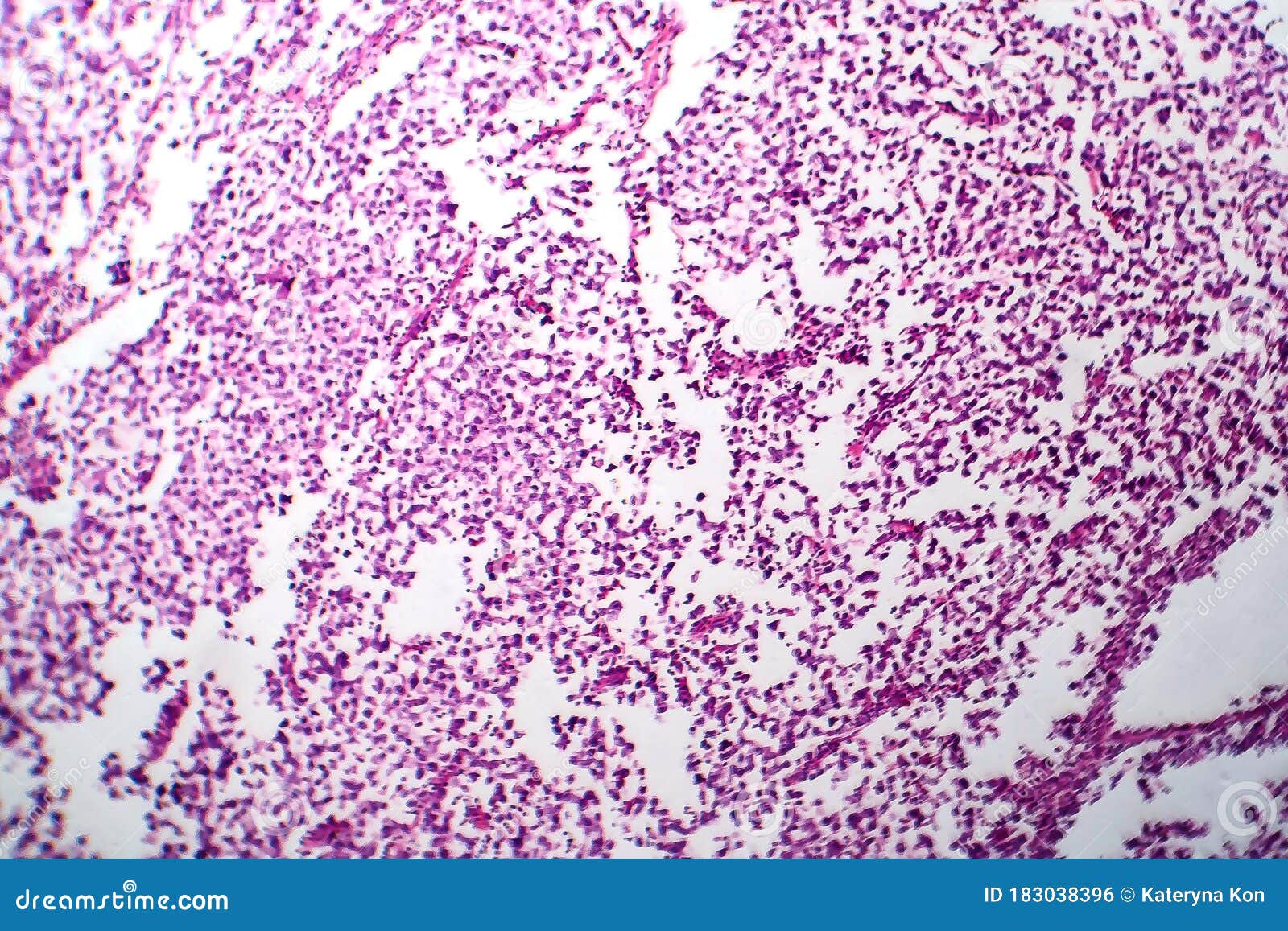 Testicular Seminoma, Light Micrograph Stock Photo - Image of germ ...