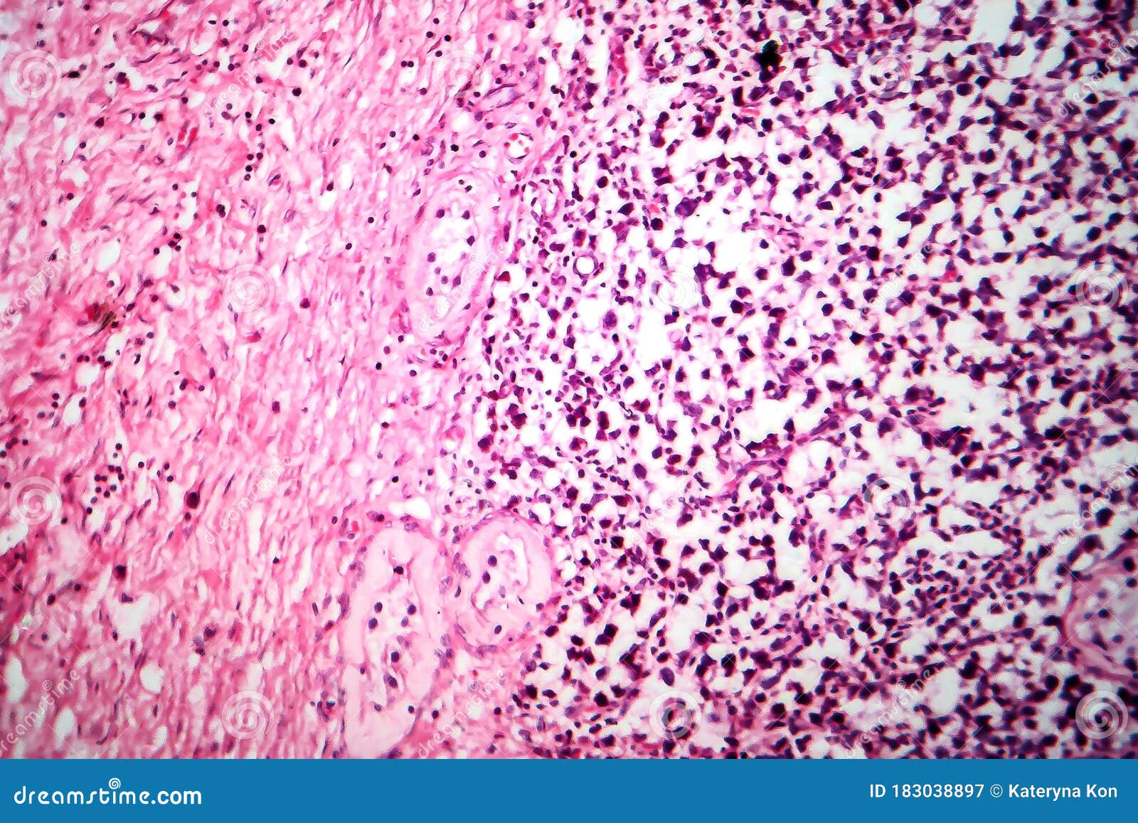 Testicular Seminoma, Light Micrograph Royalty-Free Stock Photo ...