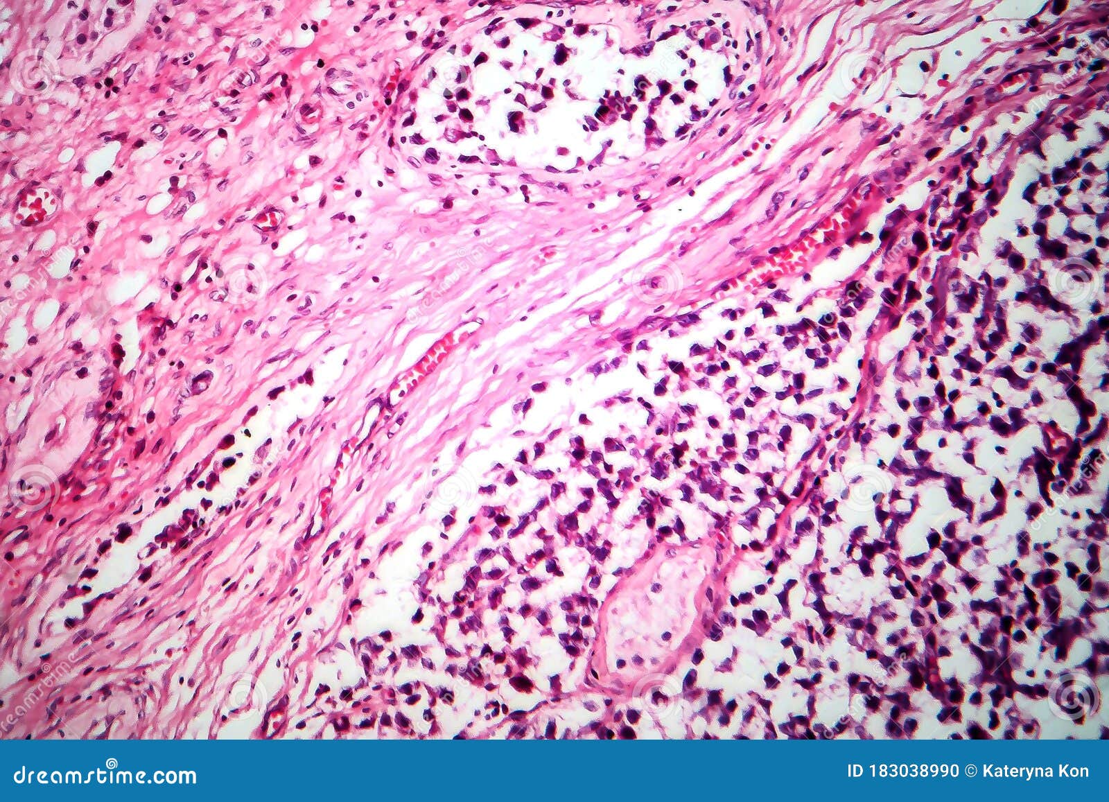 Testicular Seminoma, Light Micrograph Stock Photo - Image of medicine ...