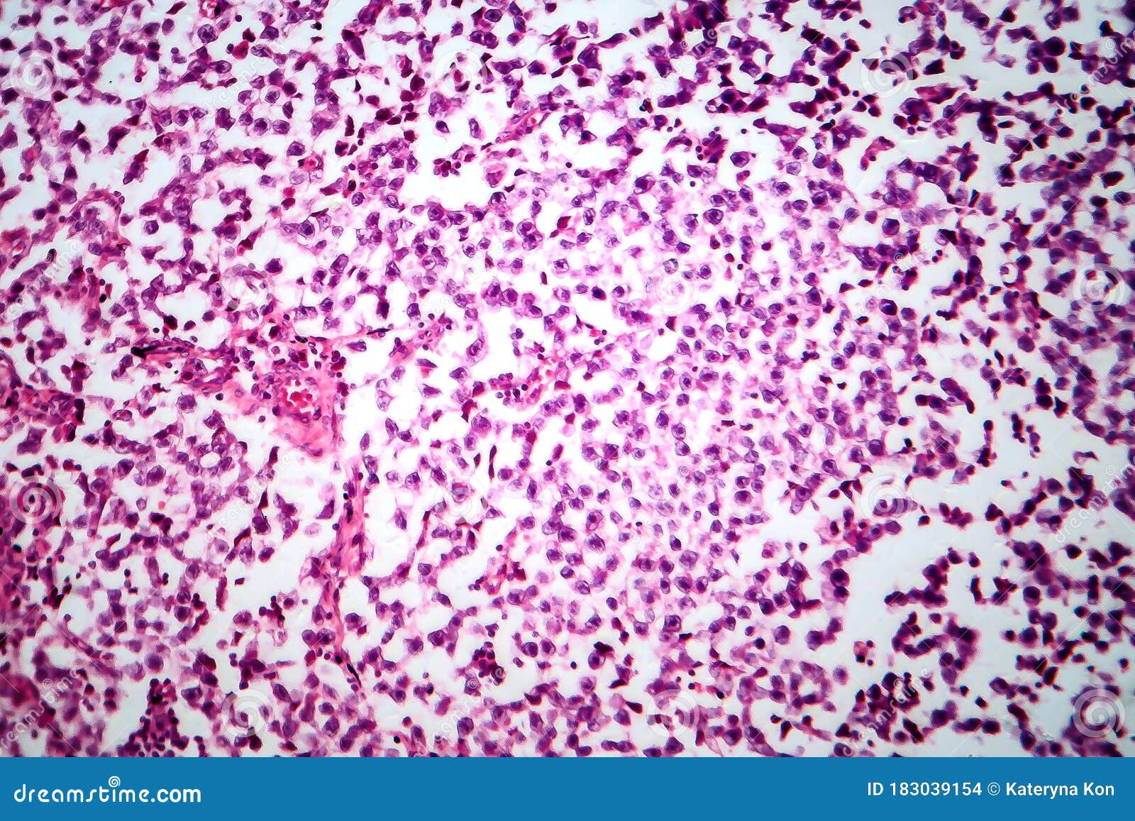 Testicular Seminoma, Light Micrograph Stock Photo - Image of neoplasm ...