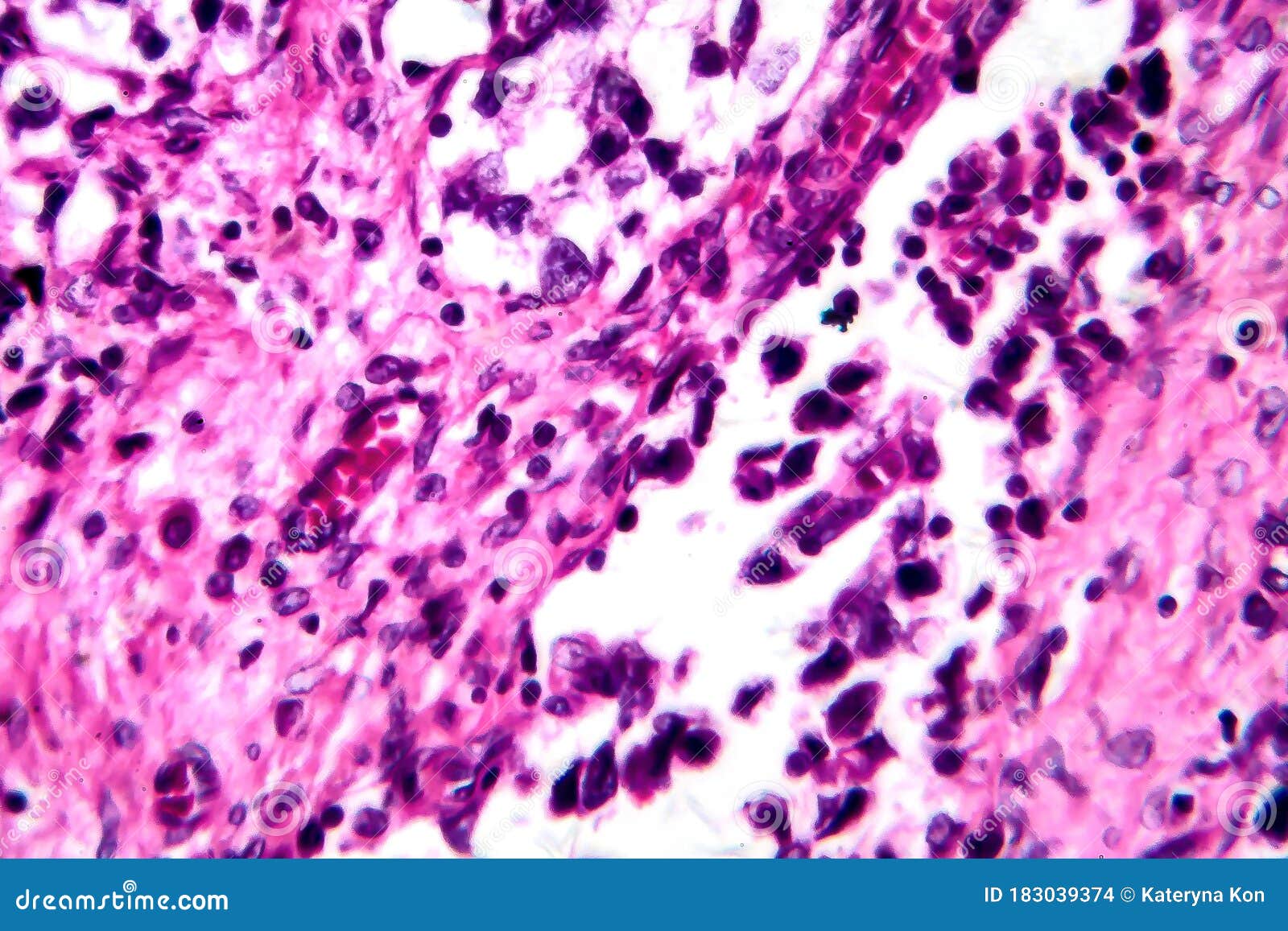 Testicular Seminoma, Light Micrograph Stock Photo - Image of germ ...