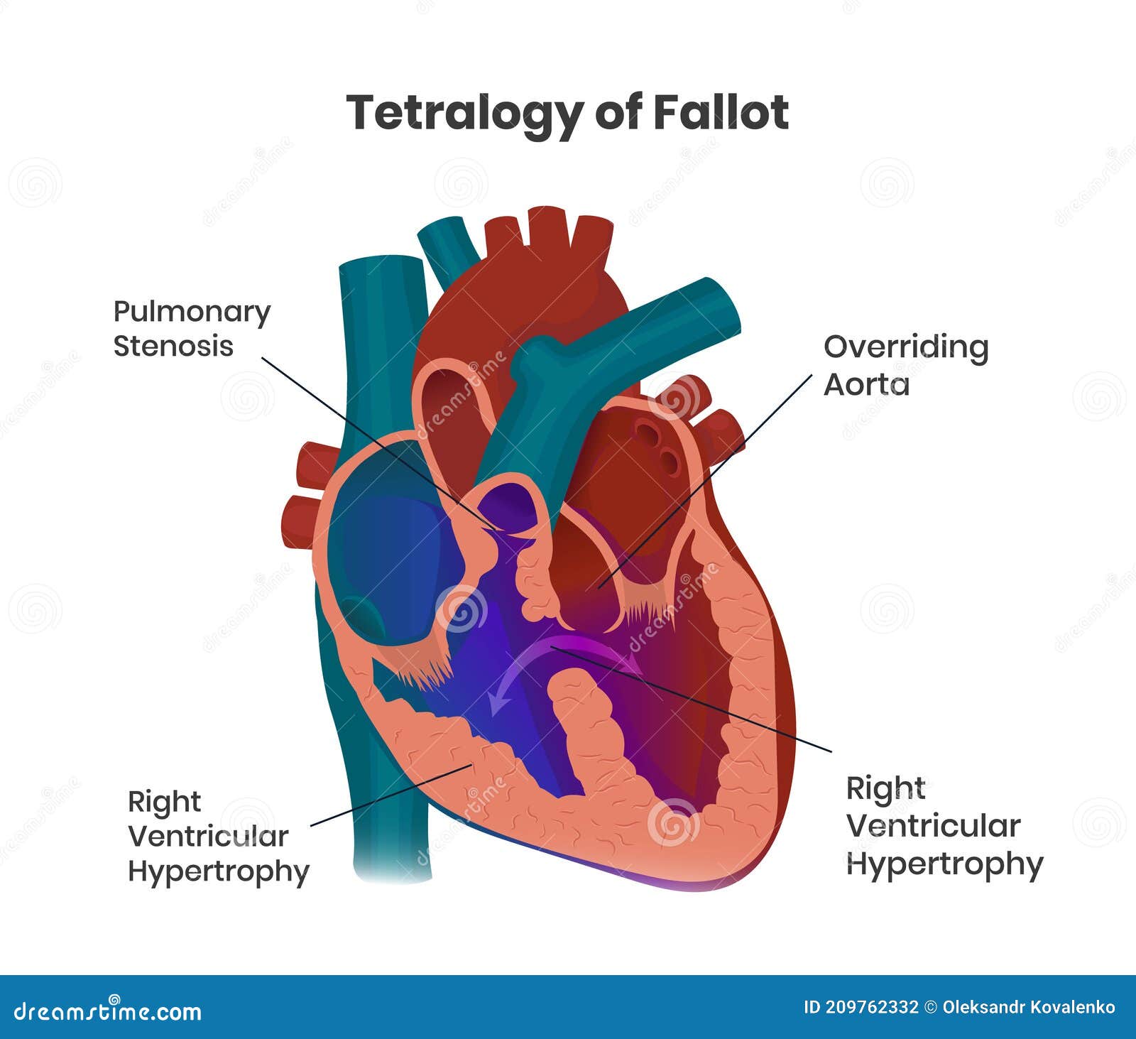 Tetralogy Of Fallot Composition Of The Heart Defects Vector Illustration Of The Congenital