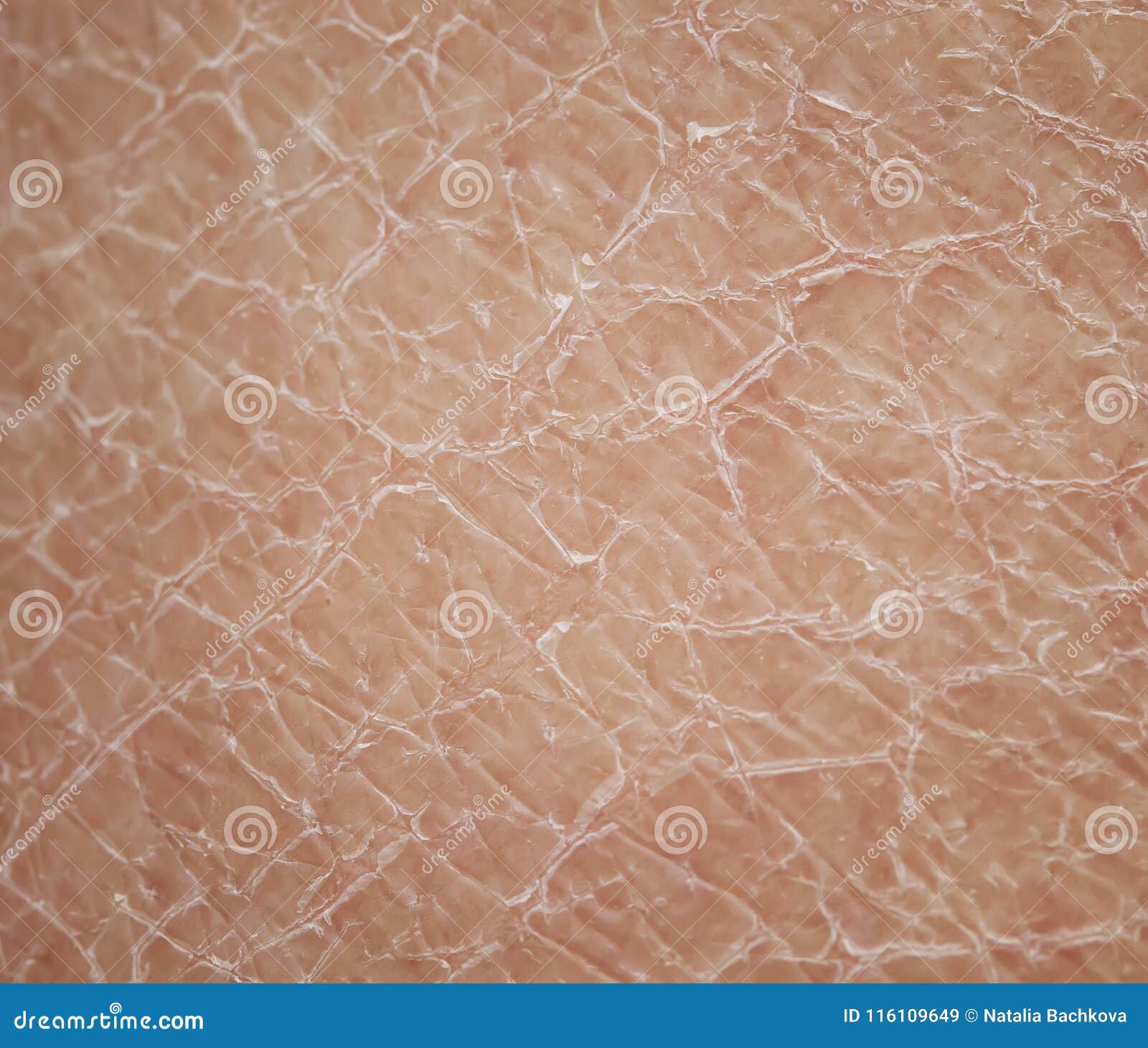 Texture Close - Up Human Skin with Dermatological Problems of Dr Stock ...