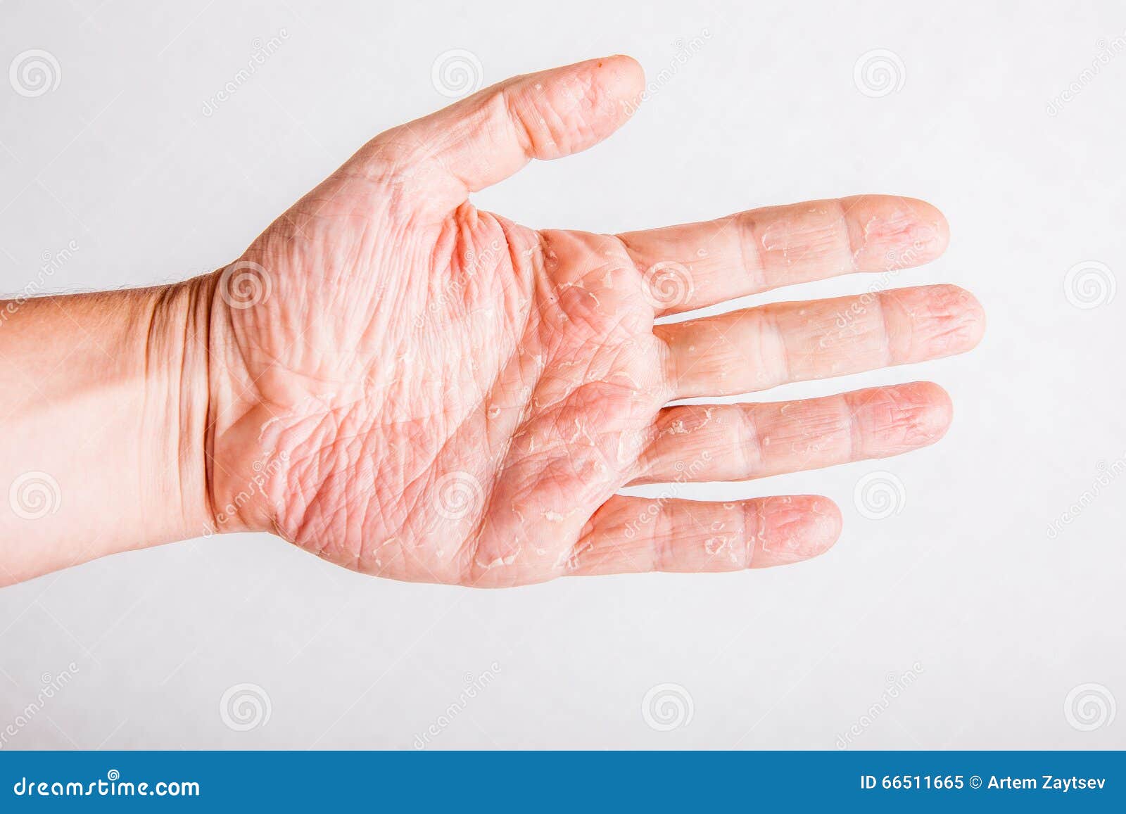 Texture De Peau De Symptôme De Dermatite Atopique D'Eczema Image stock ...