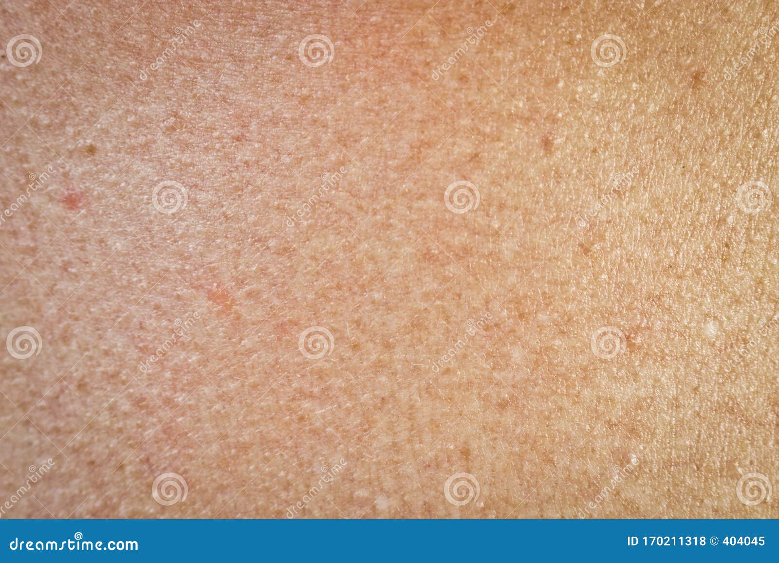 Freckles Texture