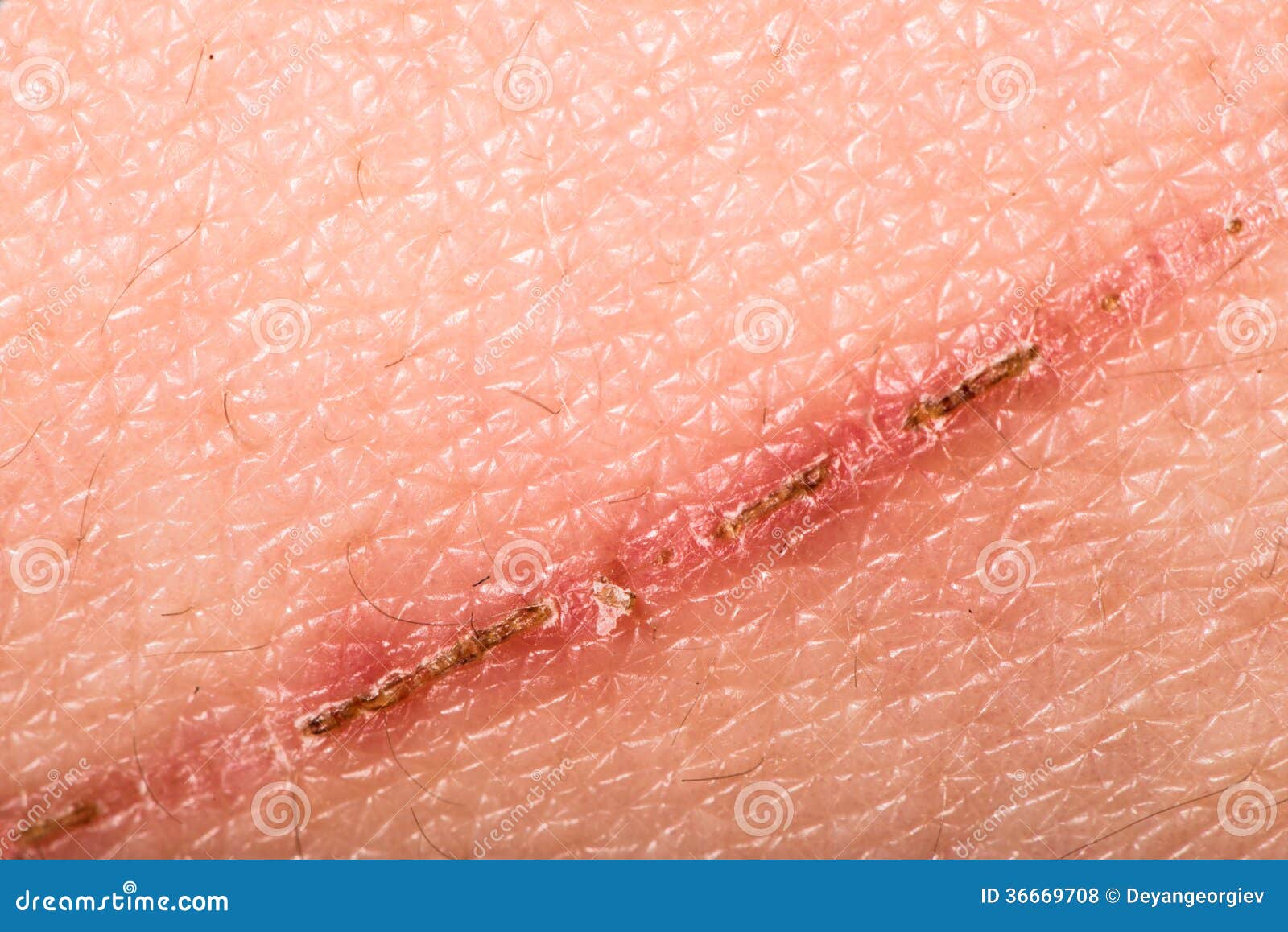Texture of Human Skin and Scratch Stock Photo - Image of health ...