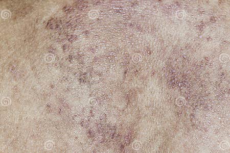Texture Red Rash on Back Man Stock Image - Image of contagious, rear ...