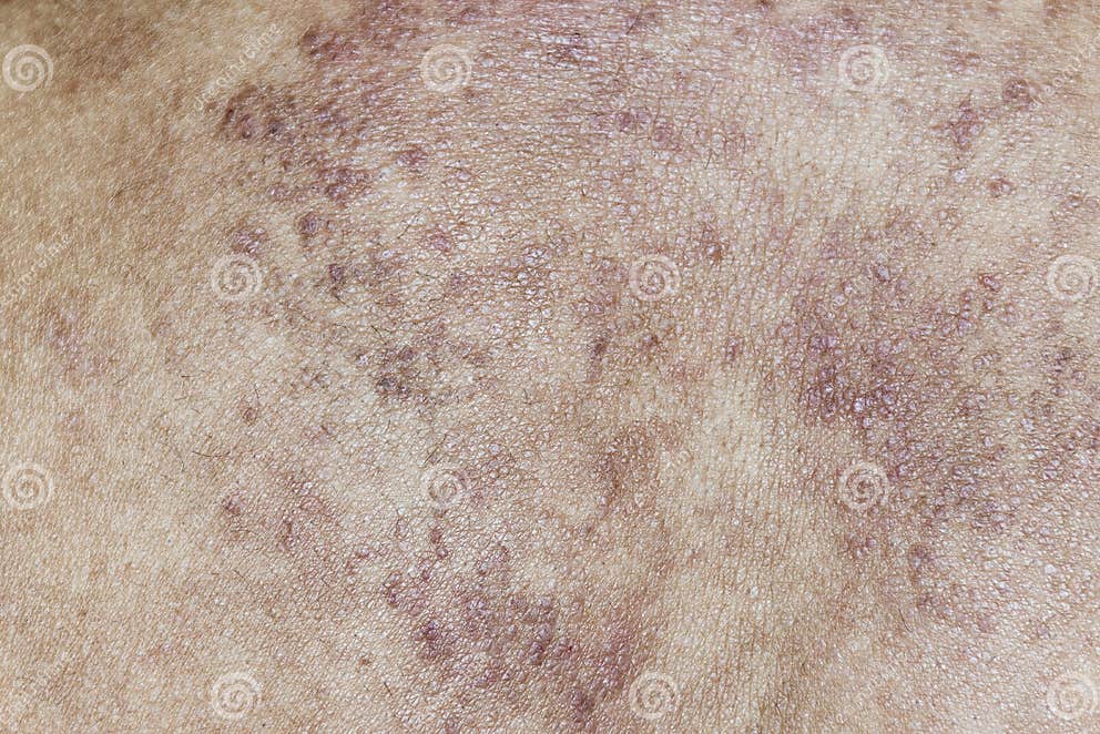 Texture Red Rash on Back Man Stock Image - Image of contagious, rear ...