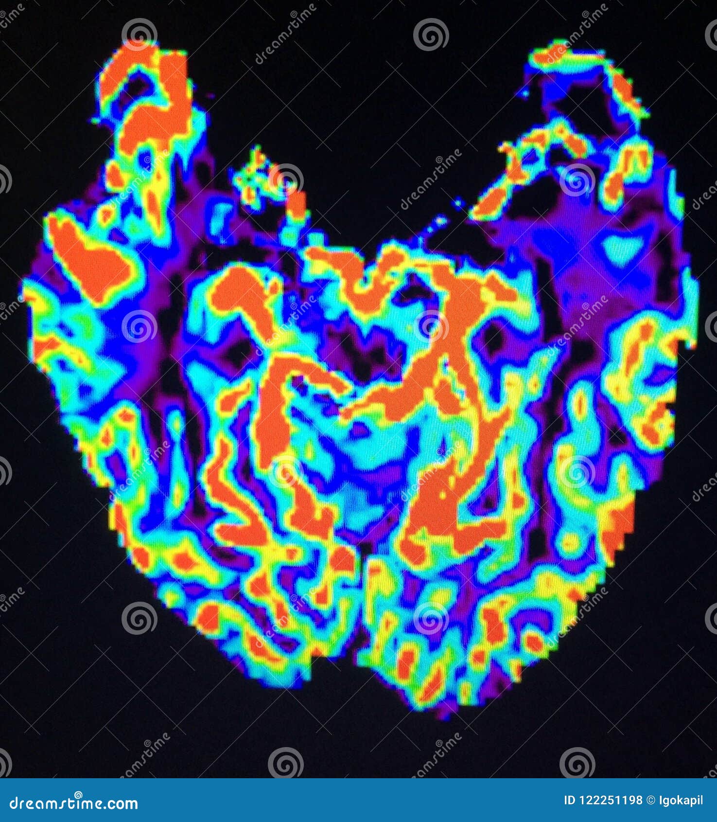 Brain Meningioma Pointing Mri Examination Stock Photo | CartoonDealer ... Brain Meningioma Pointing Mri Examination Stock Photo | CartoonDealer ...