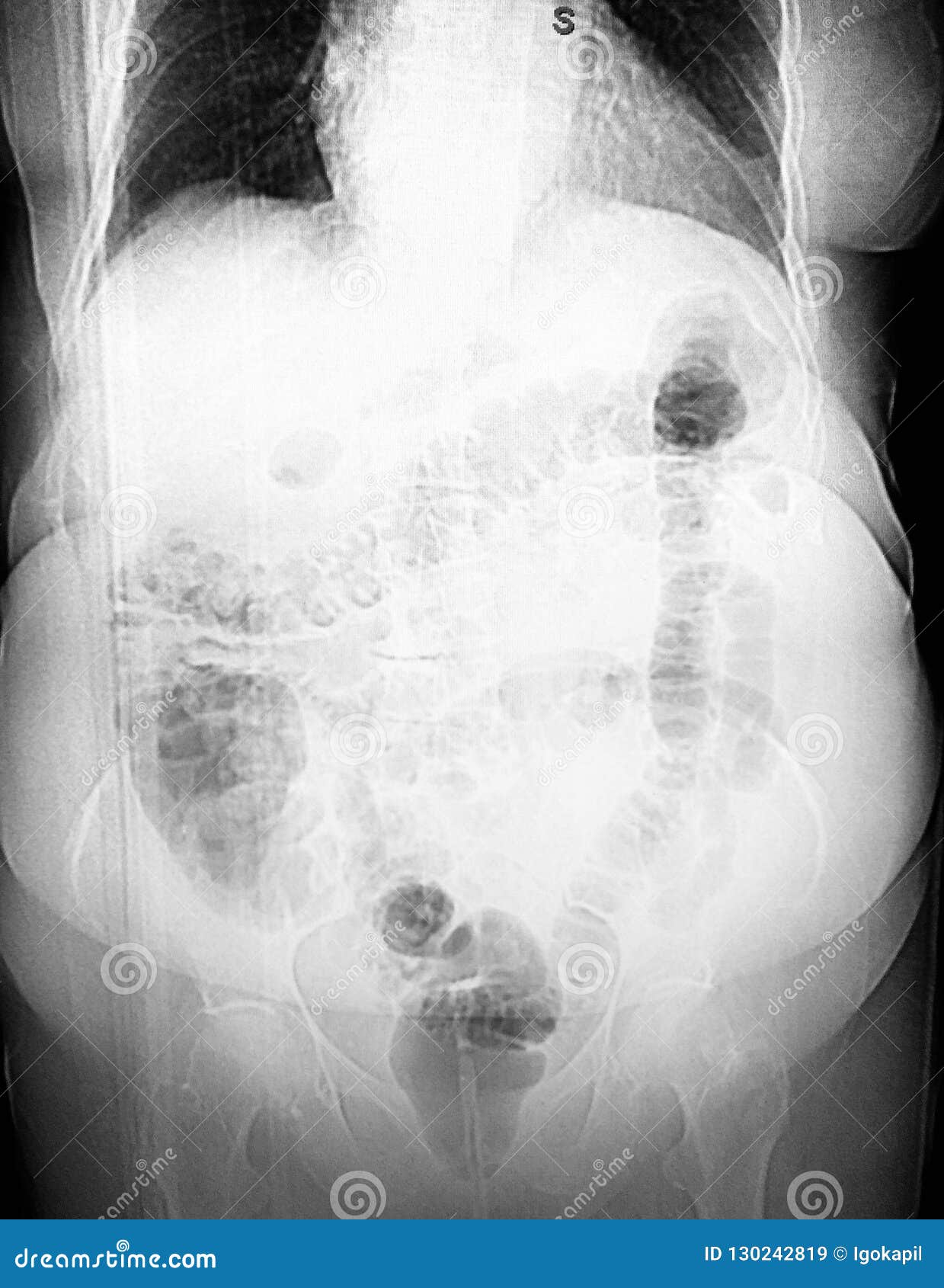 Ct Scan 3d Virtual Colonoscopy Colorful Royalty-Free Stock Photo ...